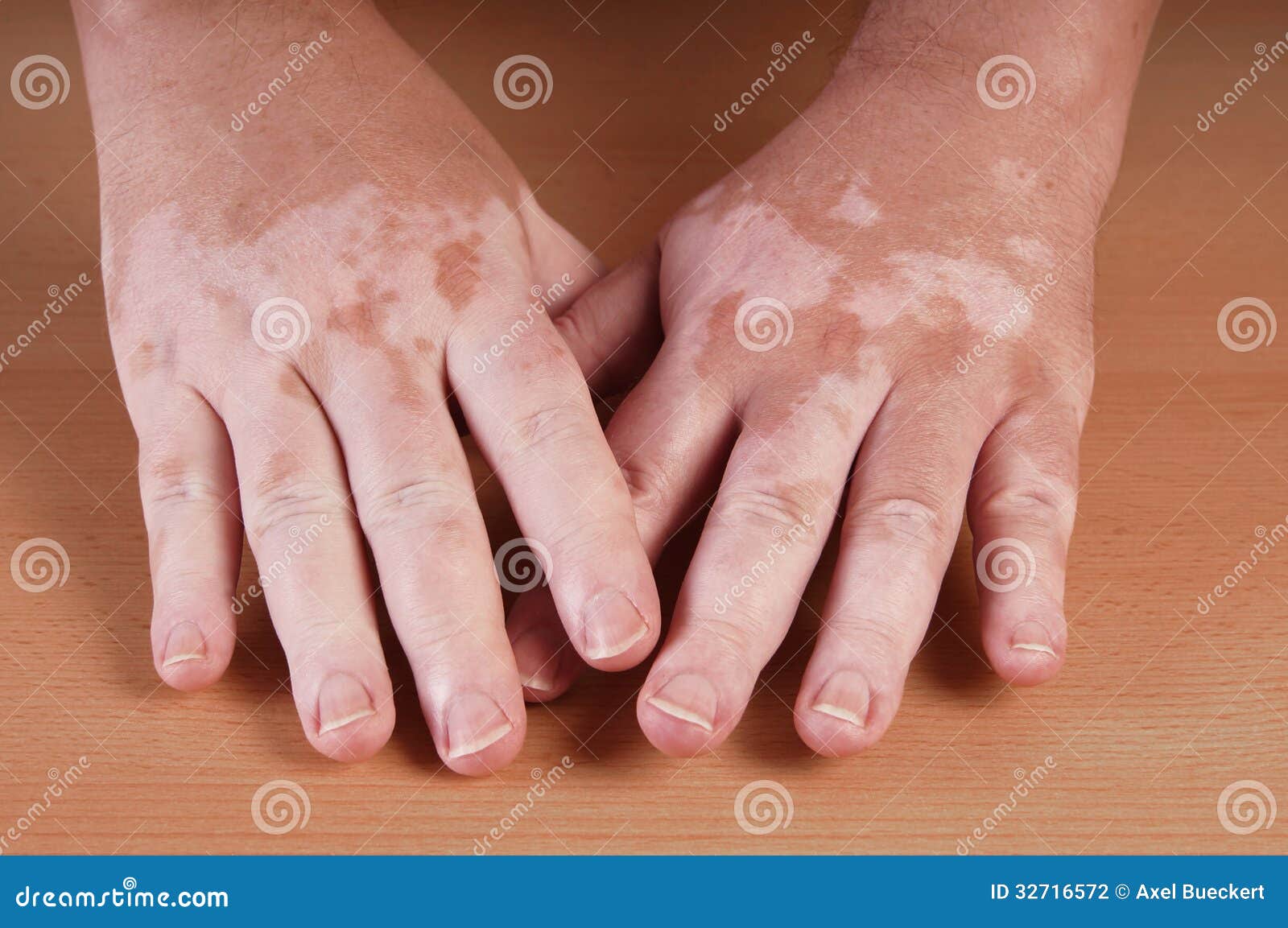 Vitiligo stock photo. Image of illness, disorder, health - 32716572