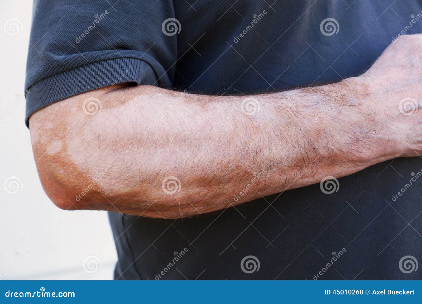 Vitiligo stock photo. Image of senior, nonsegmental, pigmentation ...