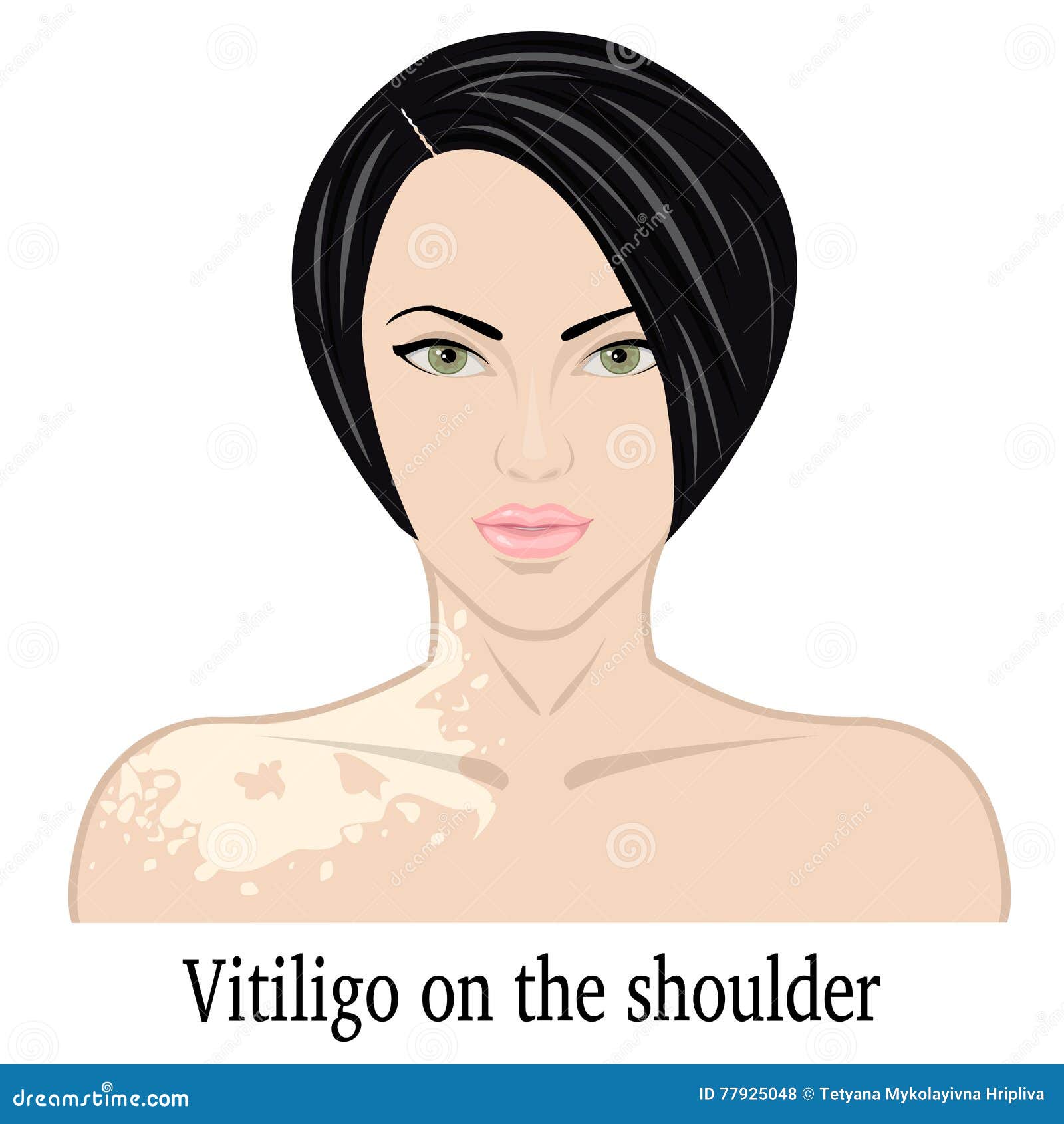 Vitiligo On The Neck And Face Cartoon Vector | CartoonDealer.com #78107621