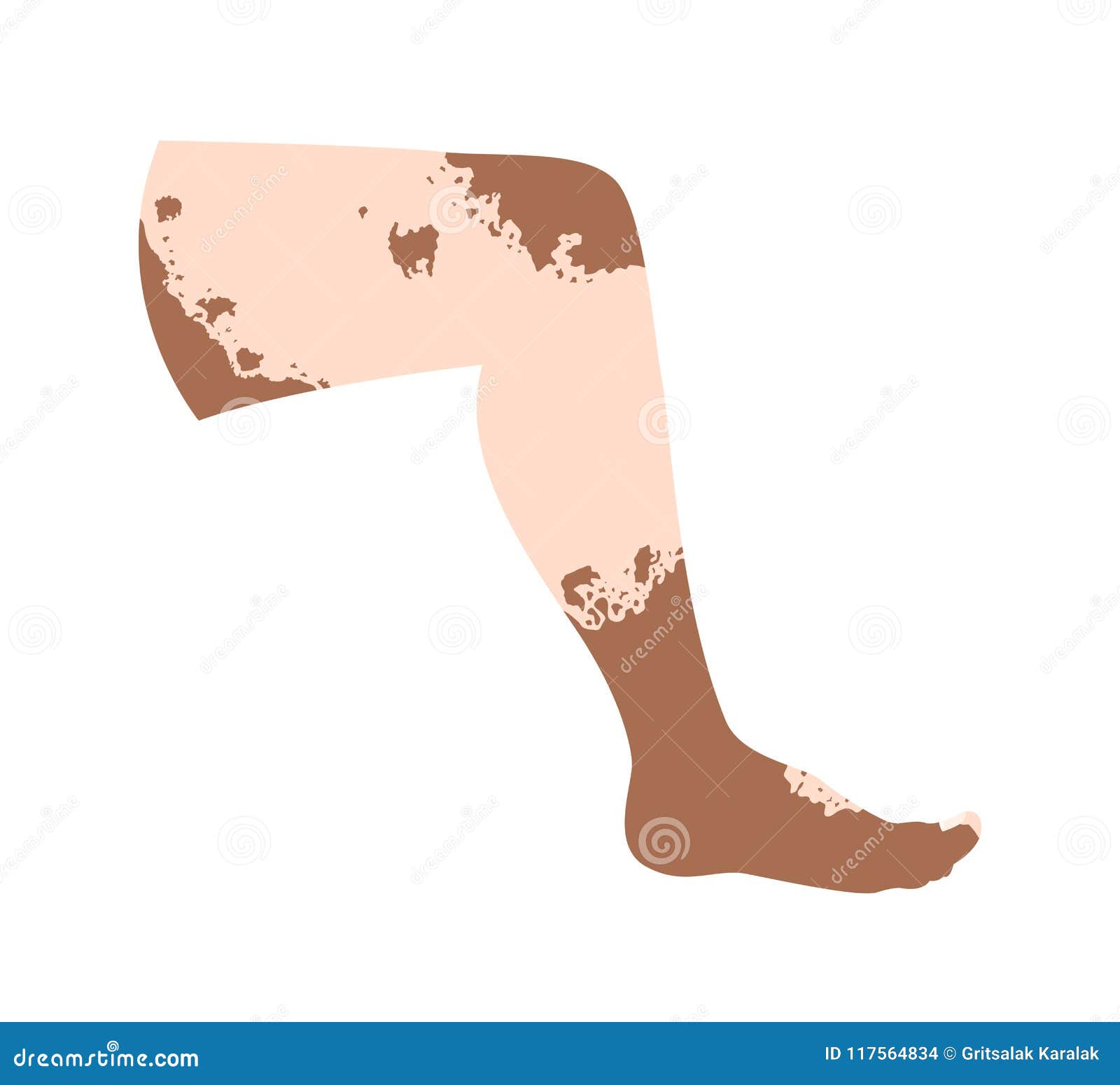 Vitiligo on Skin Layer Anatomy Stock Vector - Illustration of organ ...