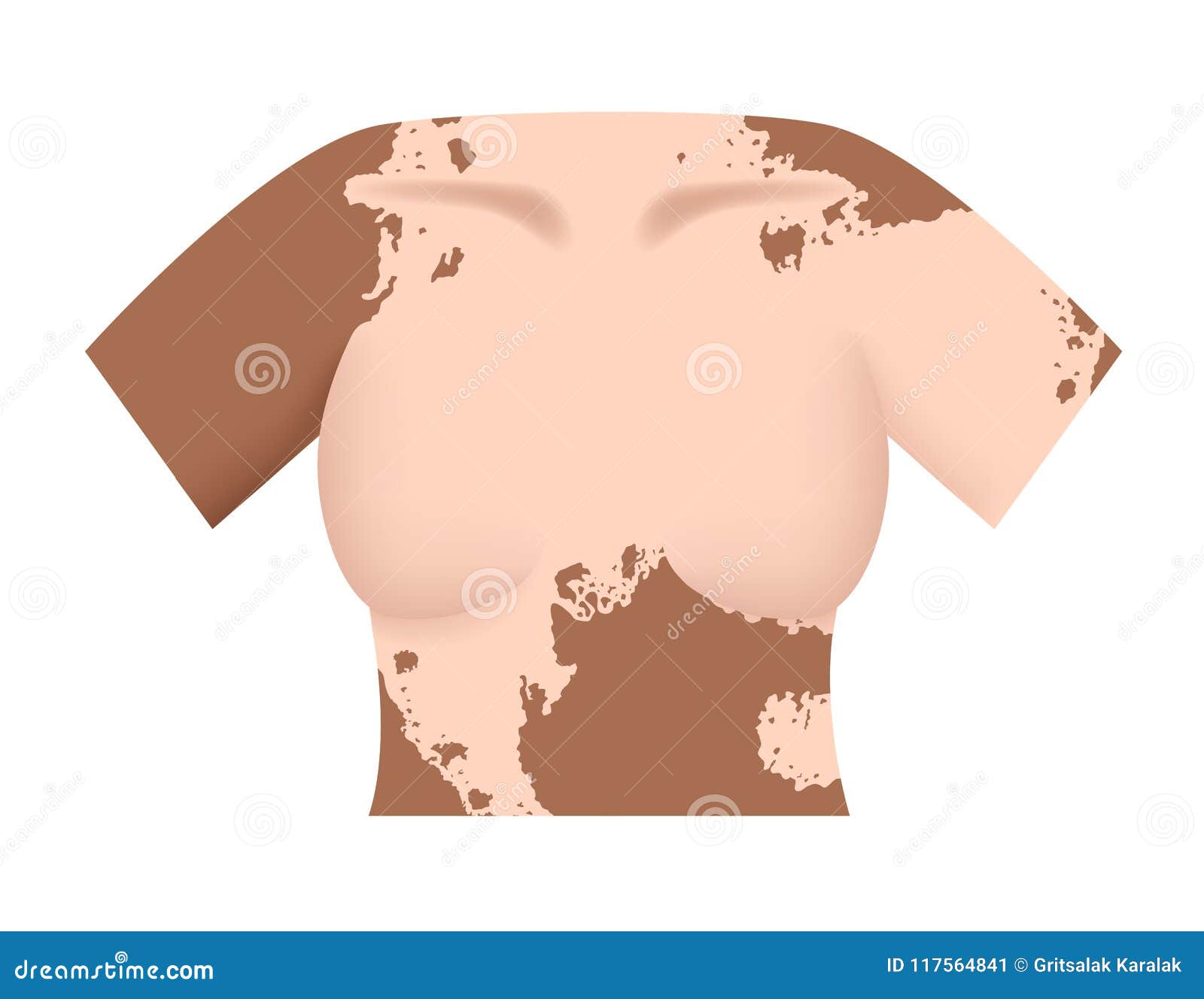 Vitiligo on Skin Layer Anatomy Stock Vector - Illustration of hair ...