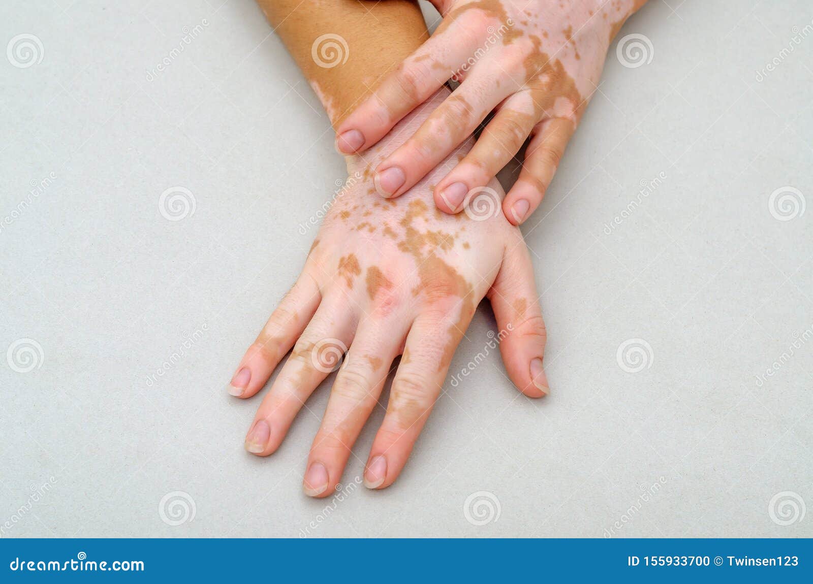 Vitiligo Sur La Peau Des Mains Photo stock - Image du fond, continuel ...