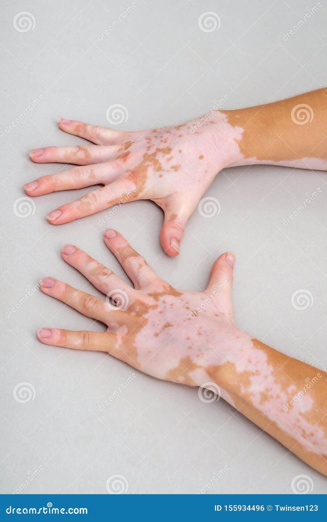 Vitiligo Sur La Peau Des Mains Photo stock - Image du état, patient ...