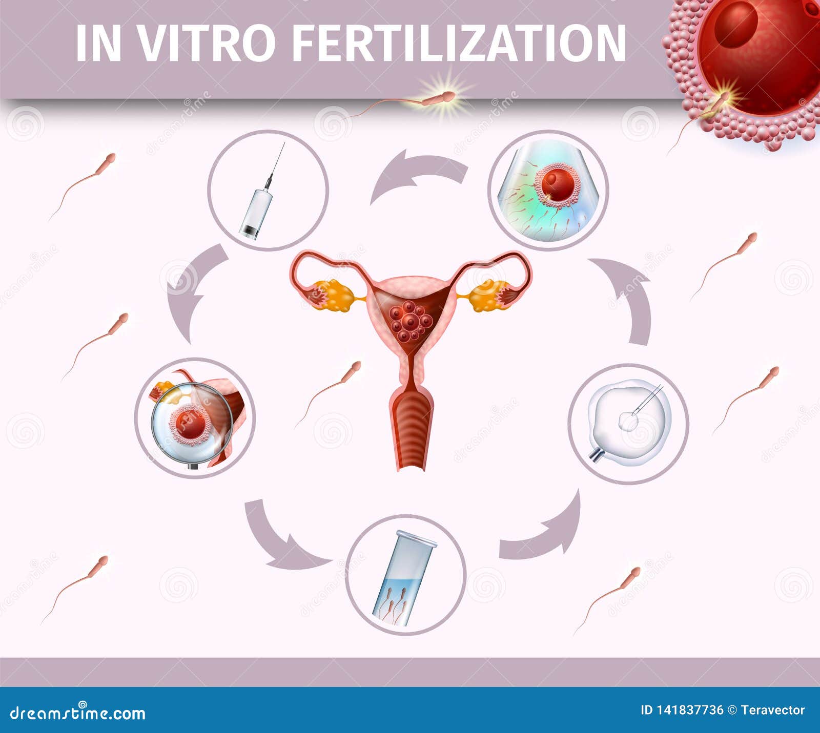 In Vitro Fertilization Colored Poster With Uterus Stock Vector