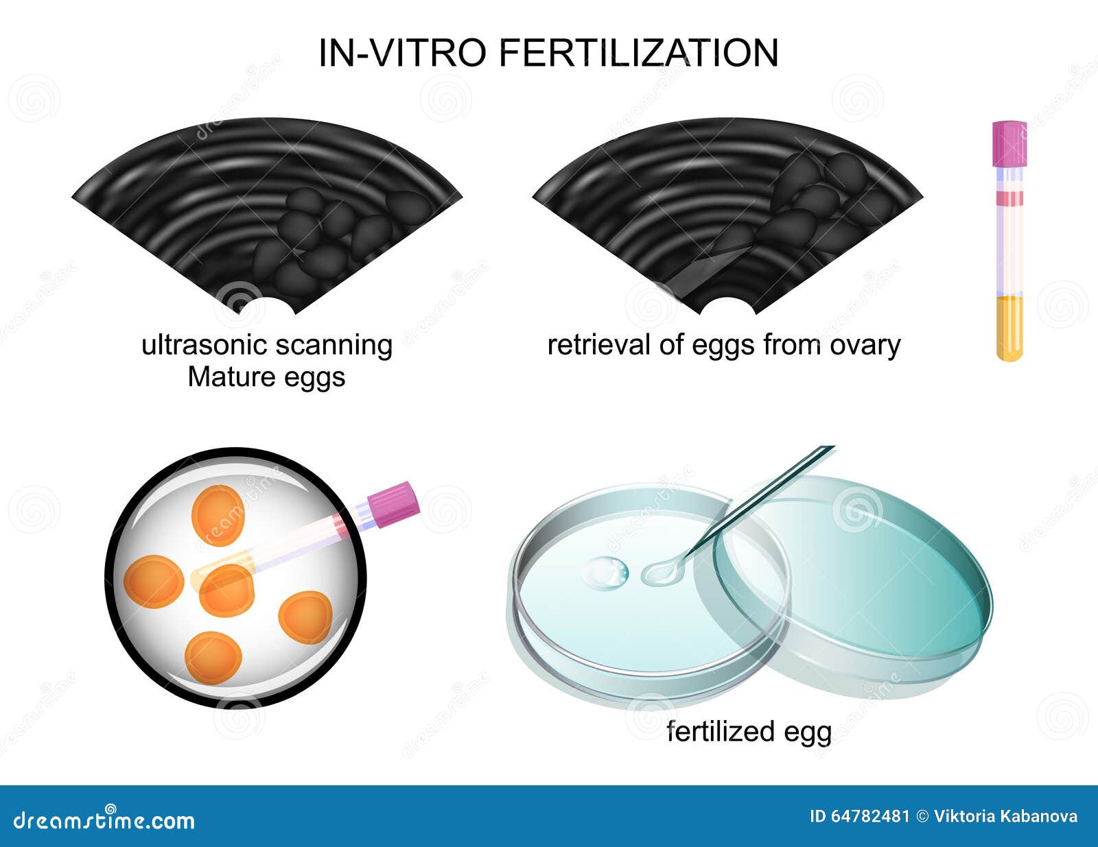 In vitro fertilization stock vector. Illustration of procedure - 64782481
