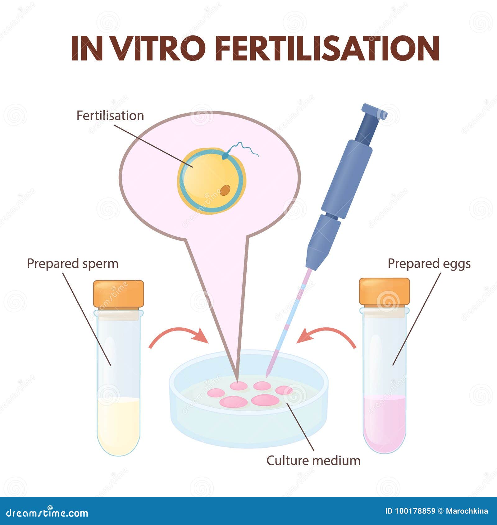 In vitro fertilization stock vector. Illustration of medicine - 100178859 In vitro fertilization stock vector. Illustration of medicine - 100178859