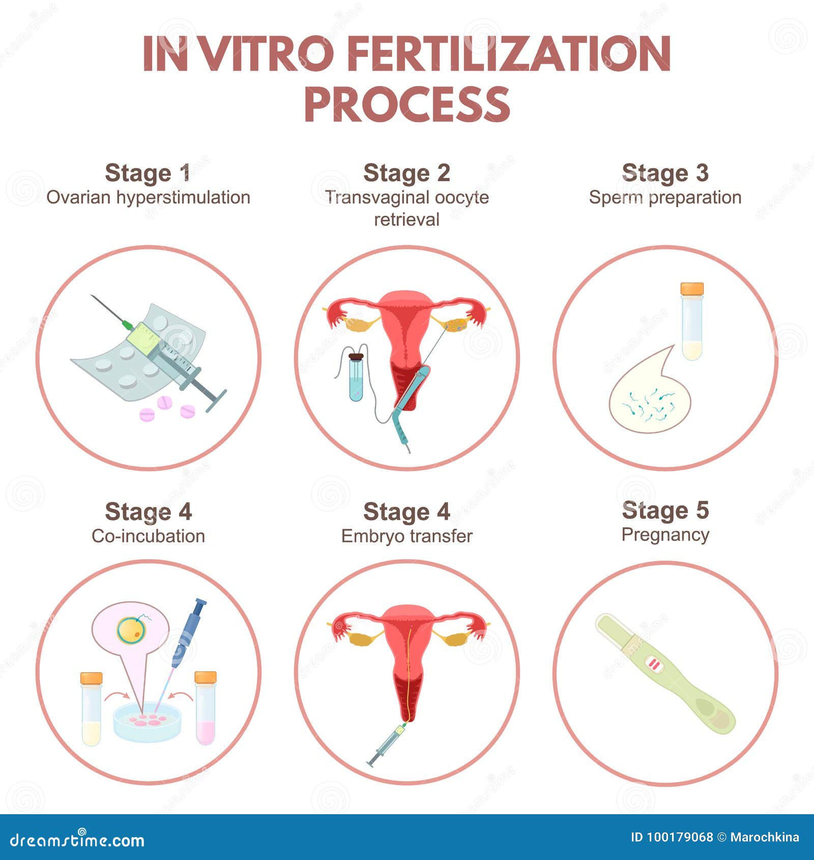 In vitro fertilization stock vector. Illustration of retrieval - 100179068 In vitro fertilization stock vector. Illustration of retrieval - 100179068