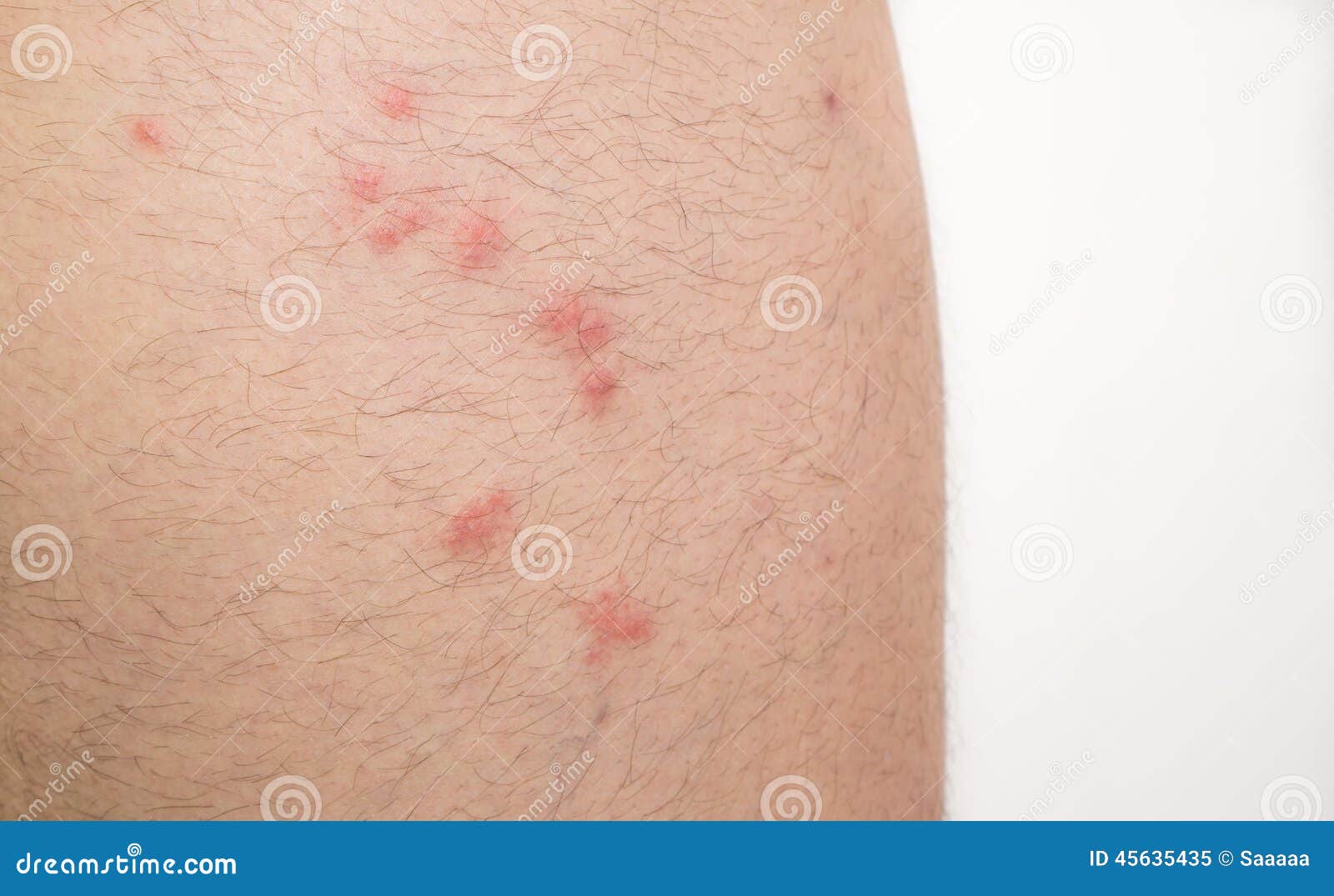 Vlobeten Op Kaukasisch Mensenbeen Stock Afbeelding - Image of jeuk ...