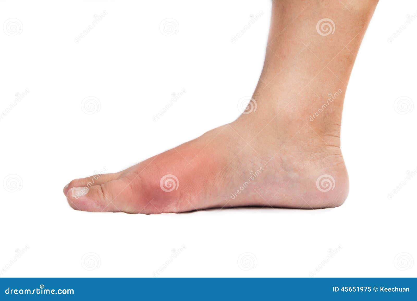 Voet met ontstoken jicht stock afbeelding. Image of gezondheid - 45651975