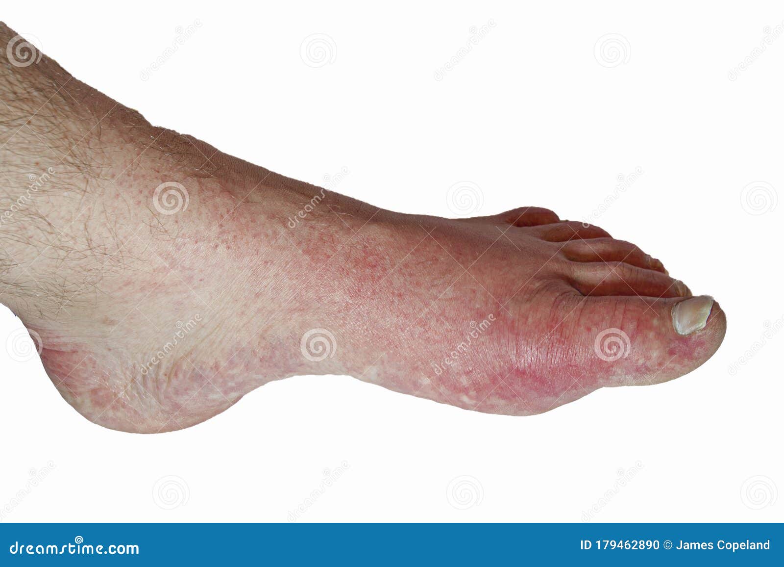 Voet Van Gezwollen Jicht Geïsoleerd Op Wit Stock Foto Image Of Podiatrie Zuur 179462890