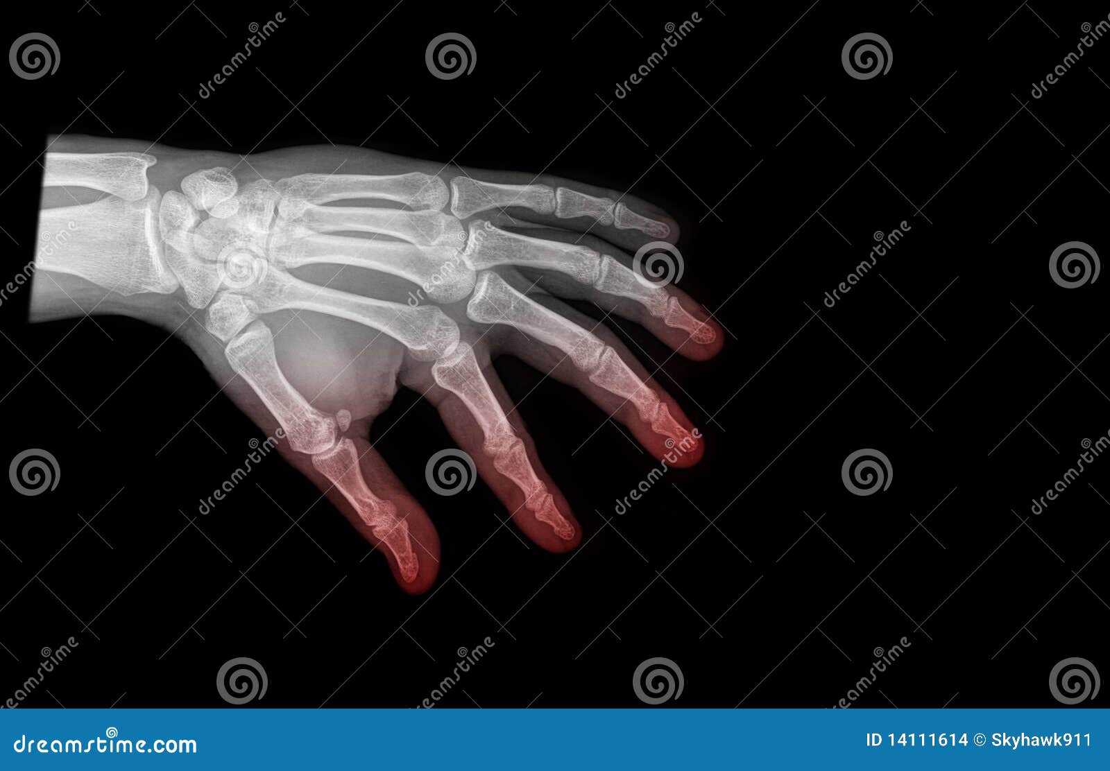 Vol De La Main Avec Le Doigt Rouge Photo stock - Image du radiographie ...