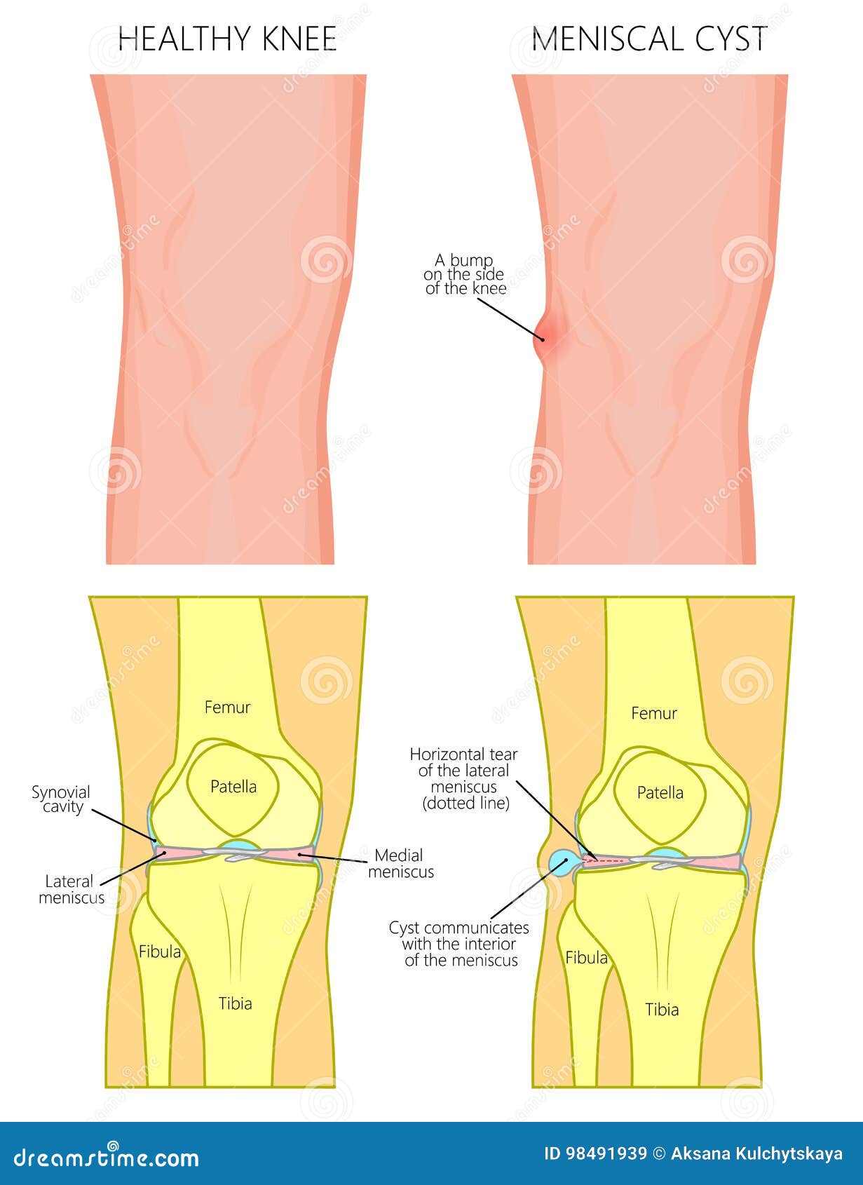 Vue De Face De Kyste _Meniscal De Ménisque Illustration de Vecteur ...