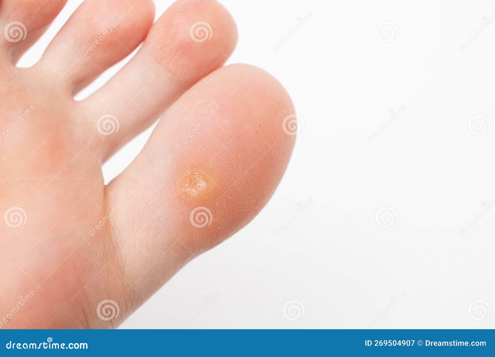 Wart on the Big Toe. Plantar Wart on Foot. Stock Image - Image of ...