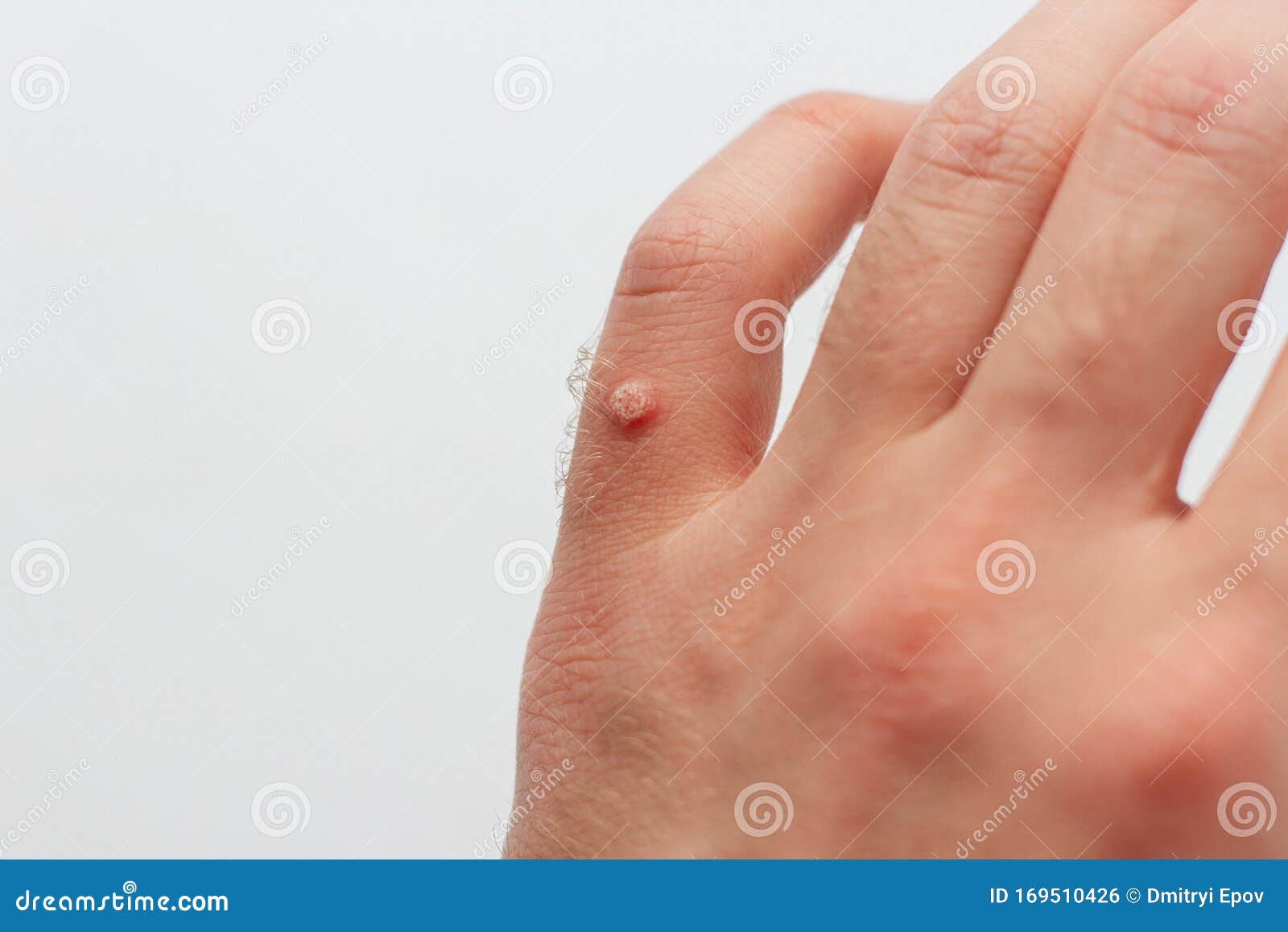Wart on Hand Finger Isolated on White Background Stock Photo - Image of ...