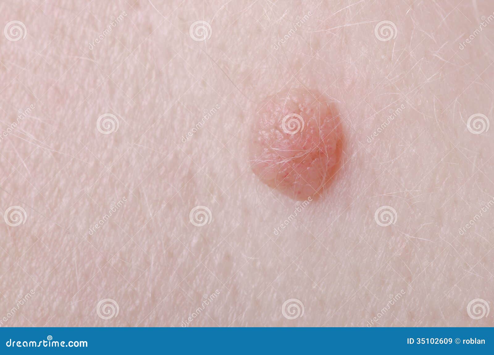 Wart stock image. Image of callus, removal, detailed - 35102609