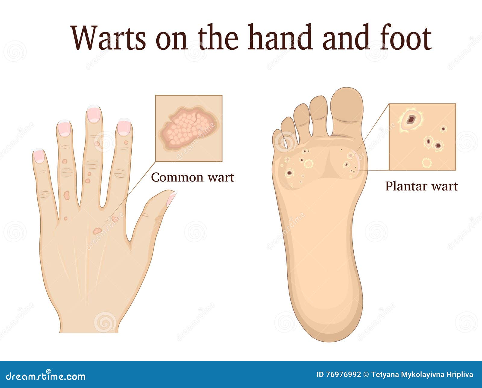 Foot Warts Vector Illustration. Scheme With Solitary And Mosaic Warts ...