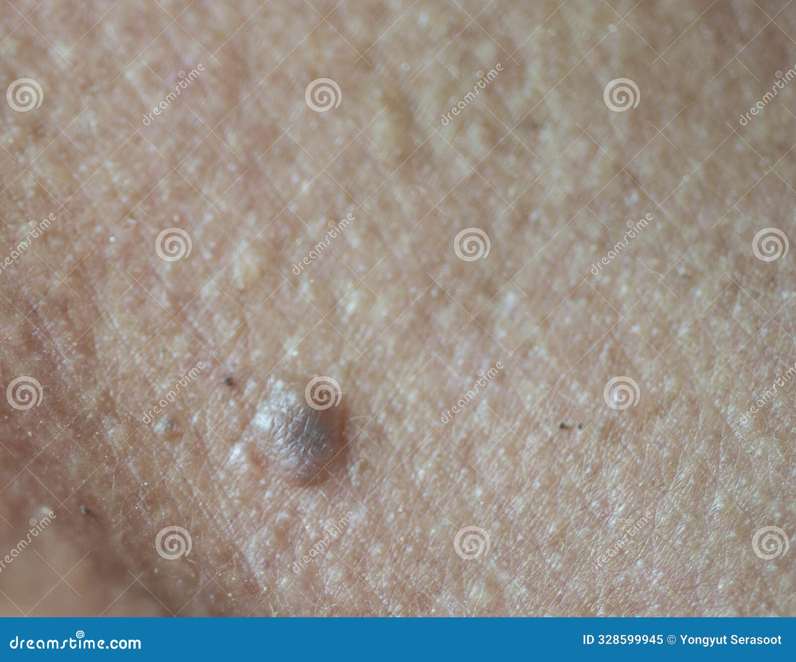 Warts on the Skin of People Stock Image - Image of heal, abnormal ...
