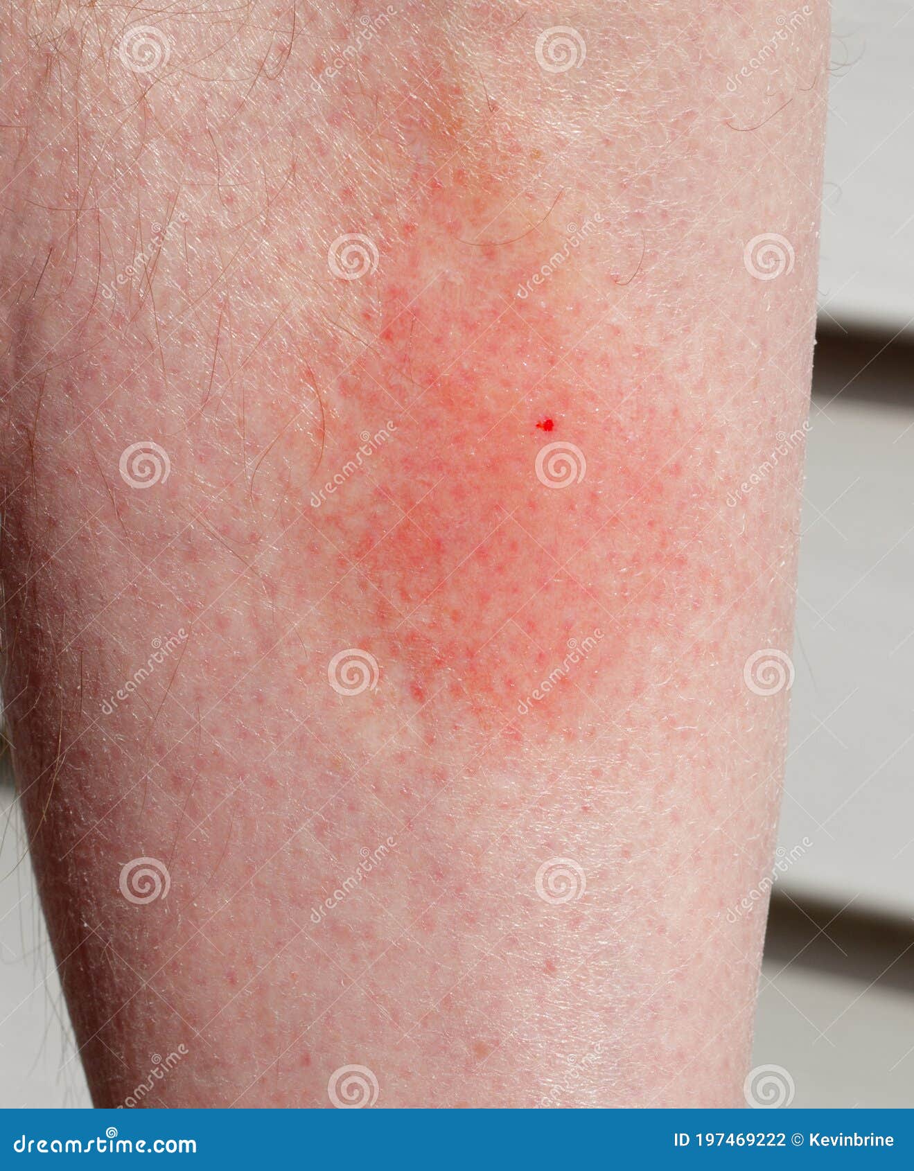 Wasp Sting stock photo. Image of shin, allergy, sting - 197469222