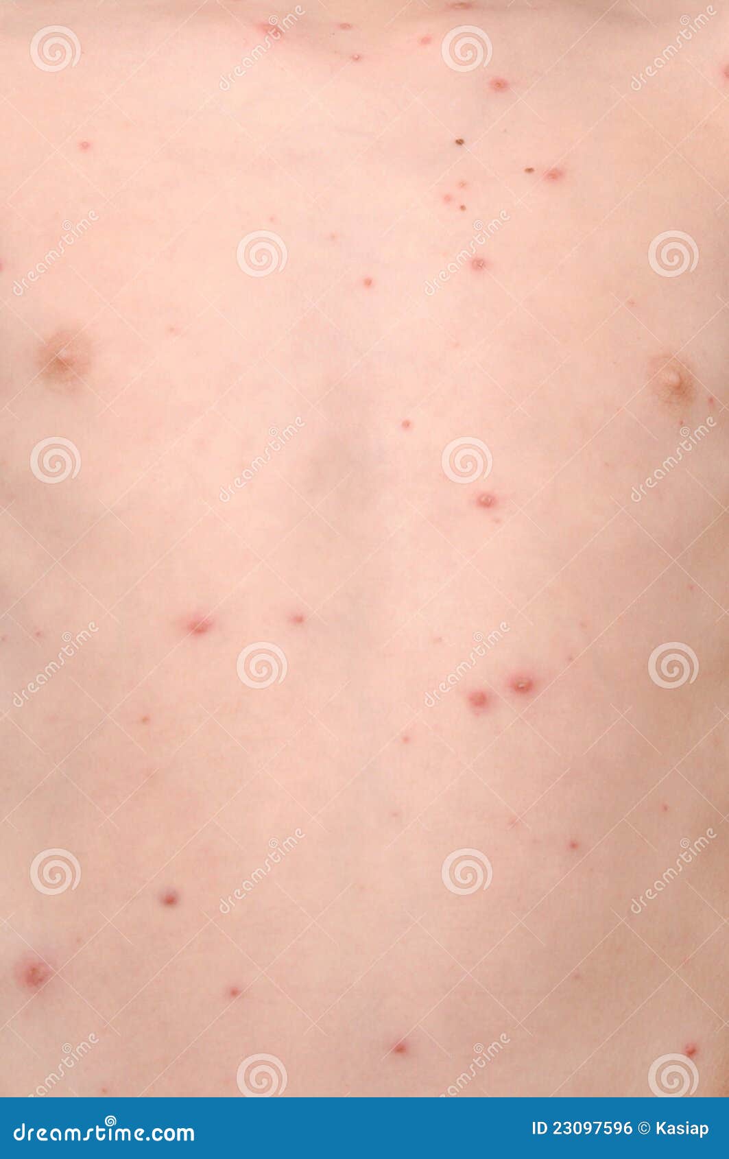 Waterpokken stock foto. Image of vlekken, symptomen, ziek - 23097596