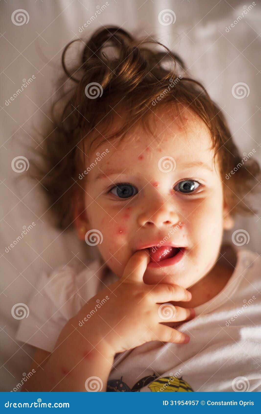 Waterpokken stock afbeelding. Image of gezondheid, leuk - 31954957