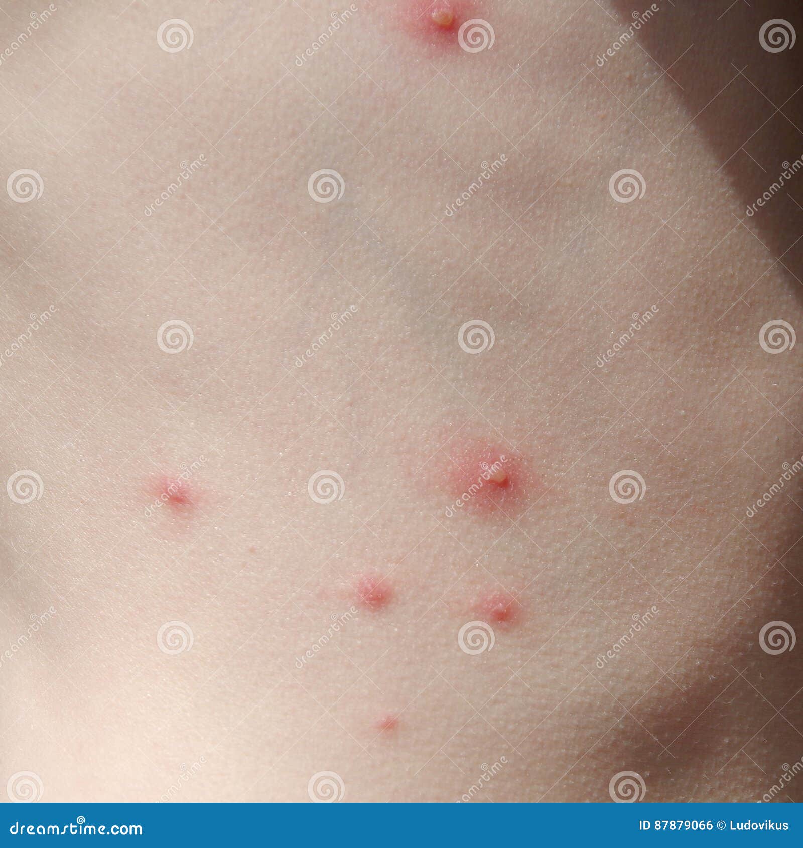 Waterpokken Op Het Lichaam Van Het Meisje Stock Foto - Image of torso ...