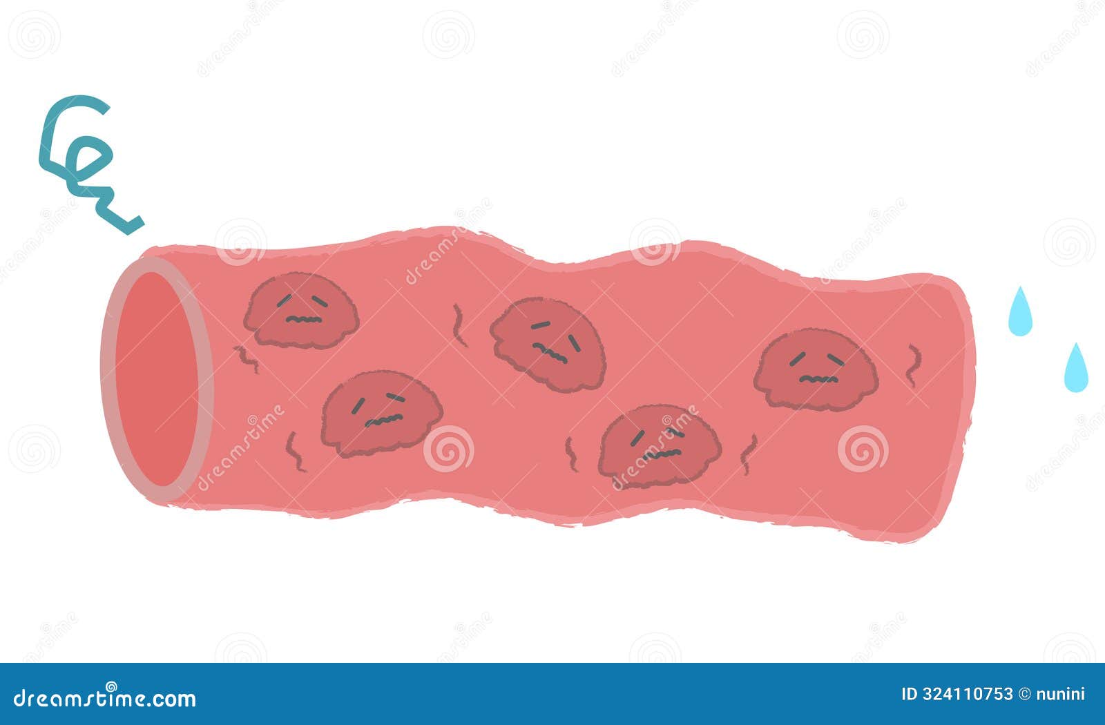Weak Blood Vessels, Muddy Blood Stock Illustration - Illustration of ...