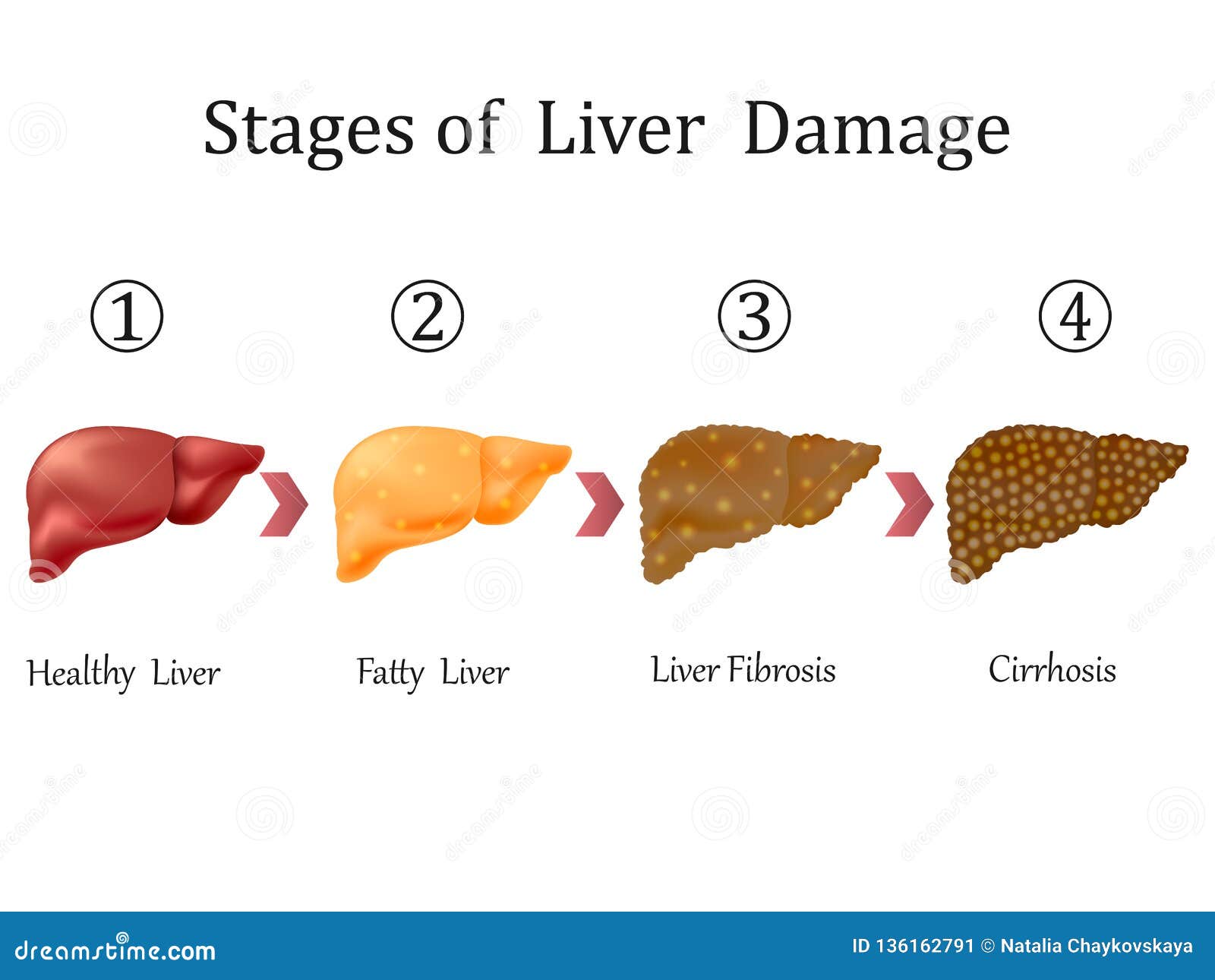Stages Of Liver Damage. The First Symptoms Of Liver Problems Are ... Stages Of Liver Damage. The First Symptoms Of Liver Problems Are ...