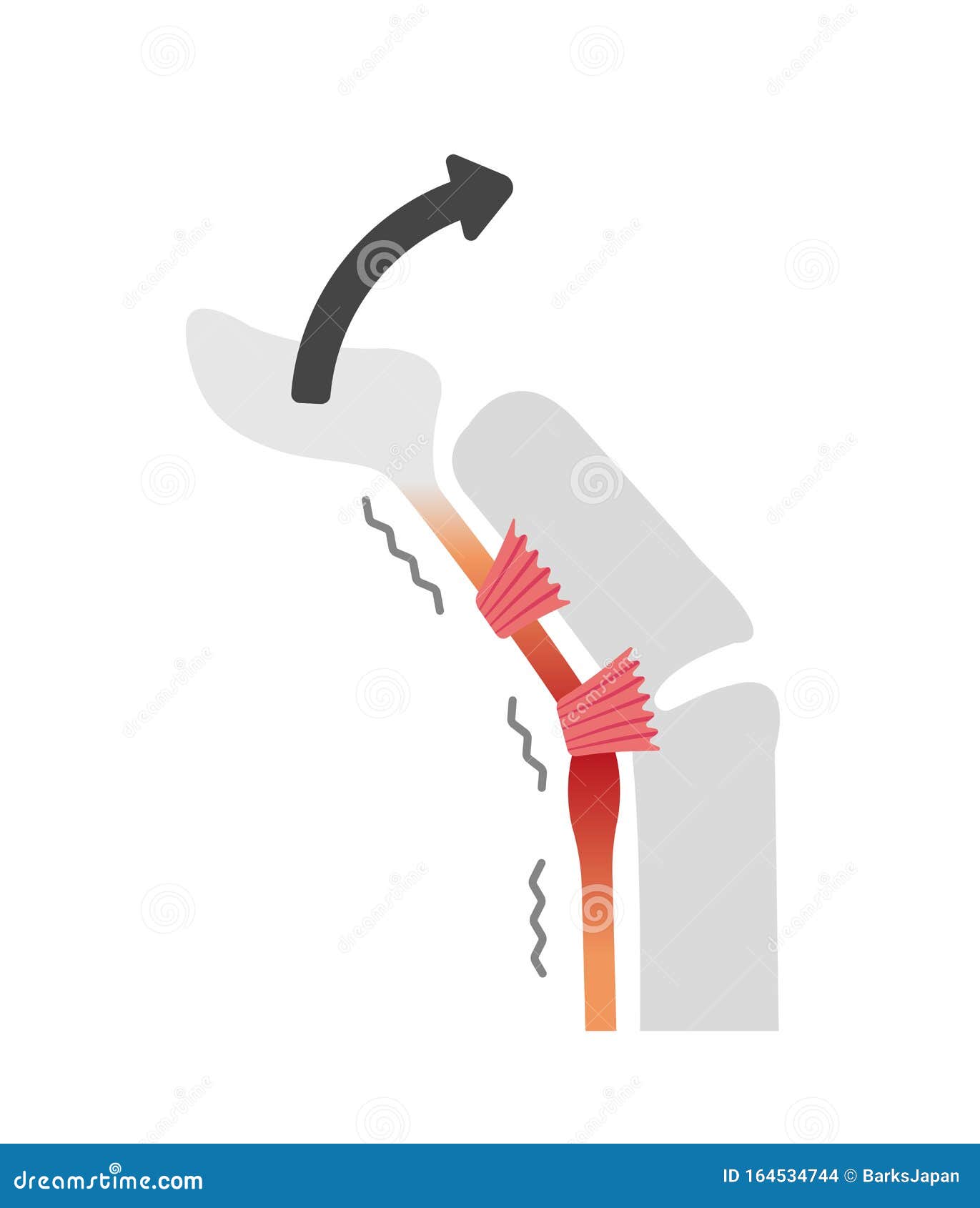 Trigger Finger Causes and Symptoms Illustration Stock Vector ...