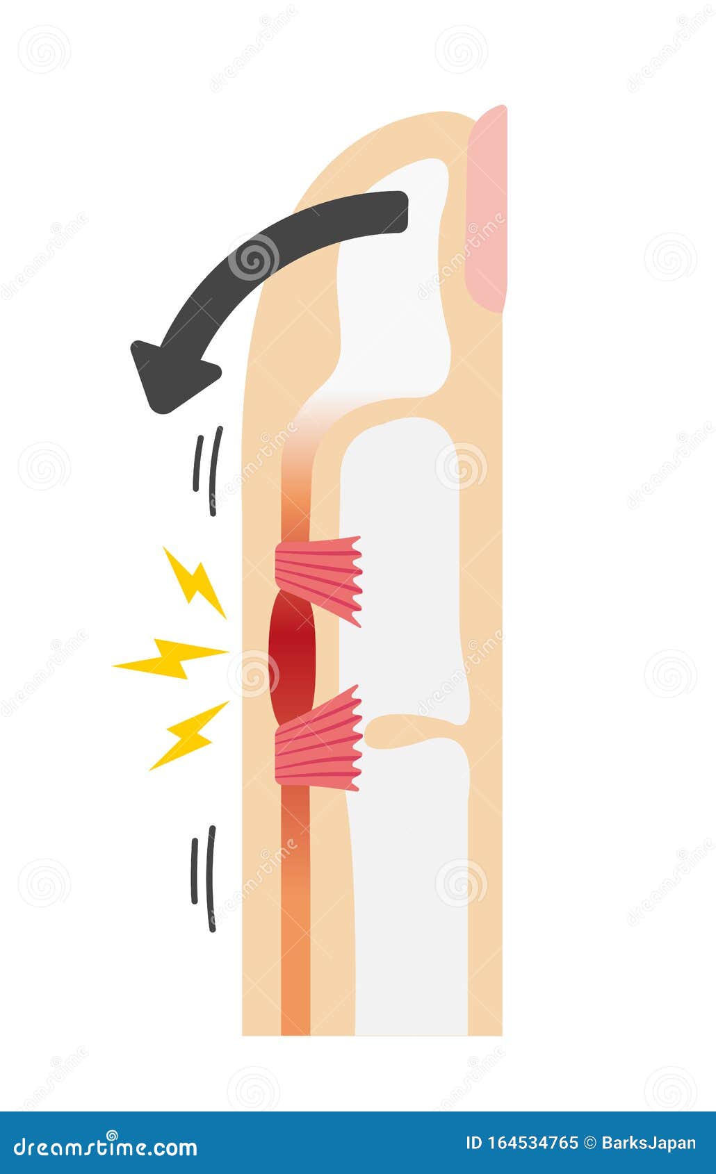 Trigger Finger Causes and Symptoms Illustration Stock Vector ...