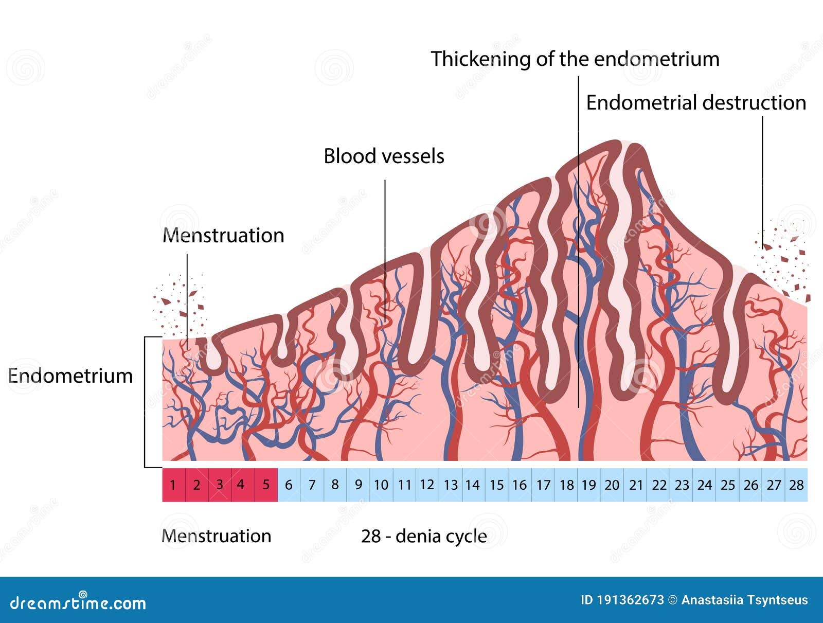 Changes in Uterine Endometrial Destruction Stock Vector - Illustration ...