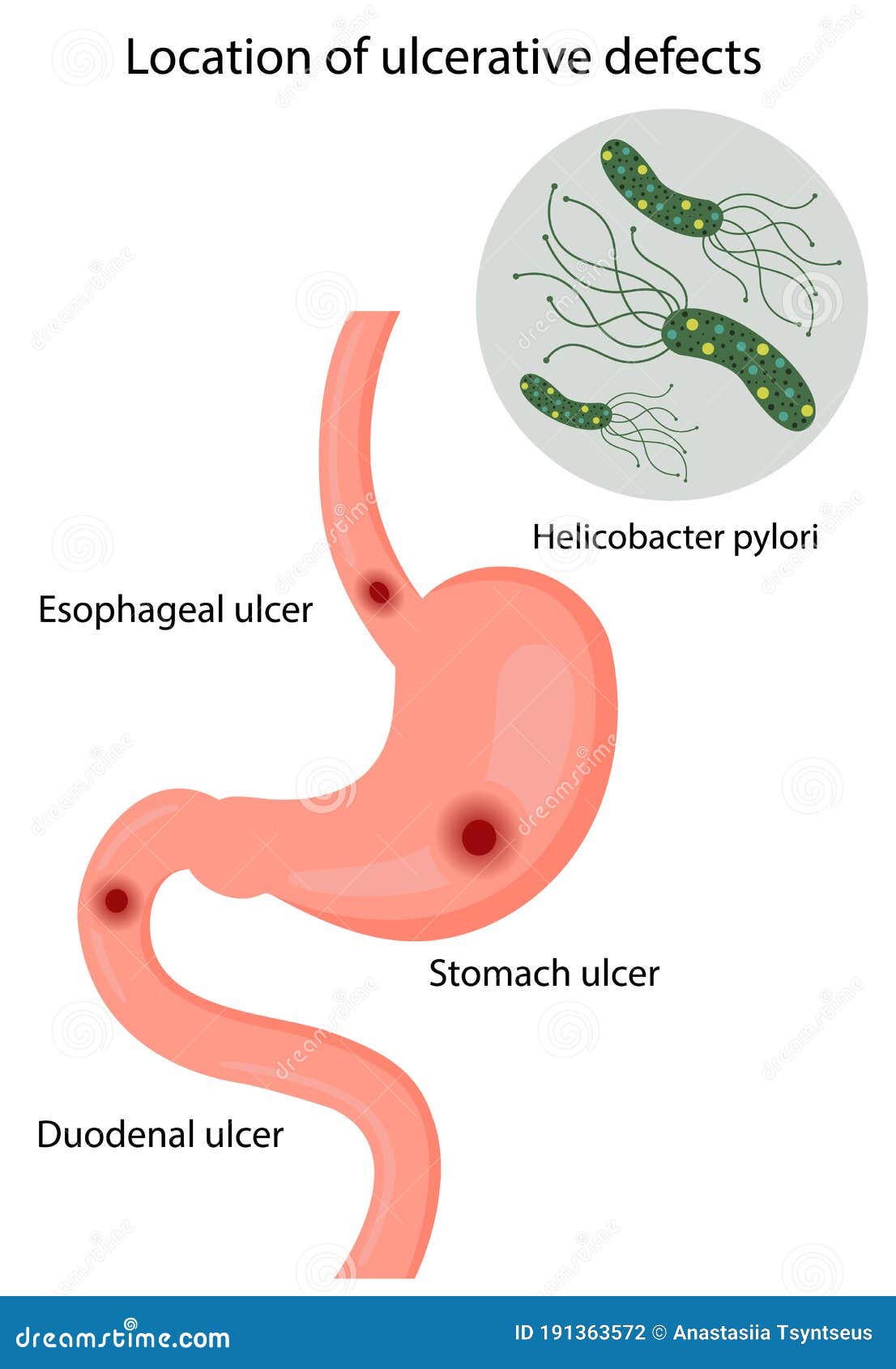 Vector Illustration of the Location of Ulcerative Defects Stock Vector ...