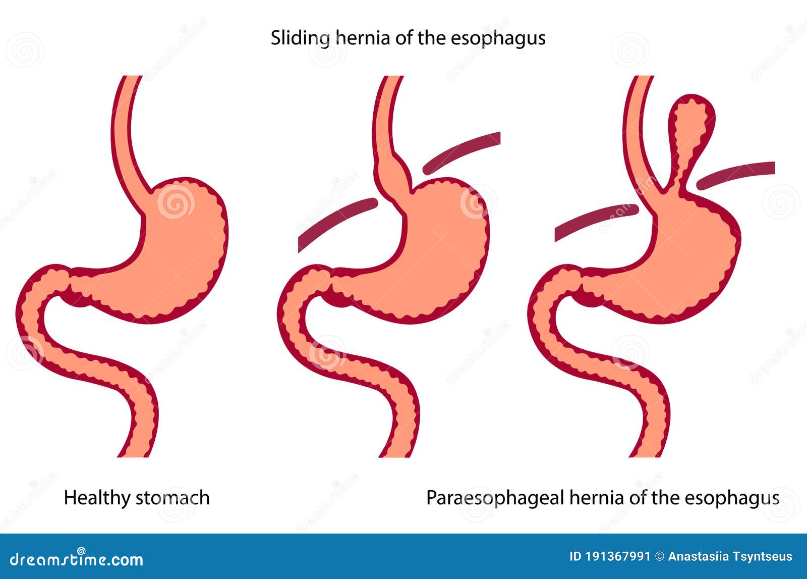 Hernia Disease Stock Illustrations – 741 Hernia Disease Stock ...