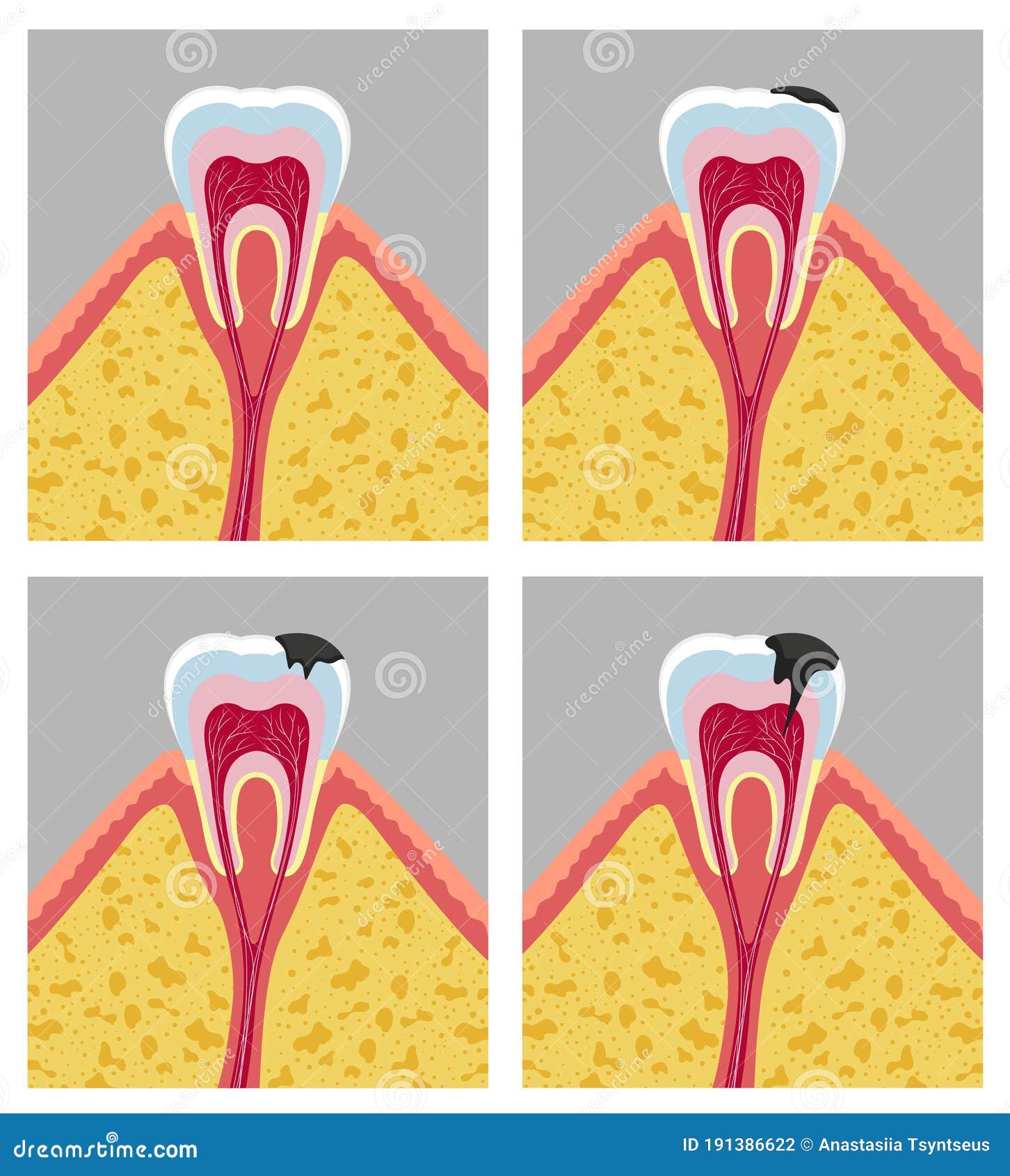 The Stages Of Tooth Decay / Flat Vector Illustration Set ...