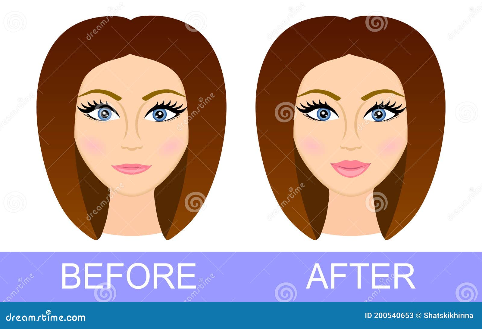 Before After Lip Correction. Woman After Using Lip Filler. Lip ...