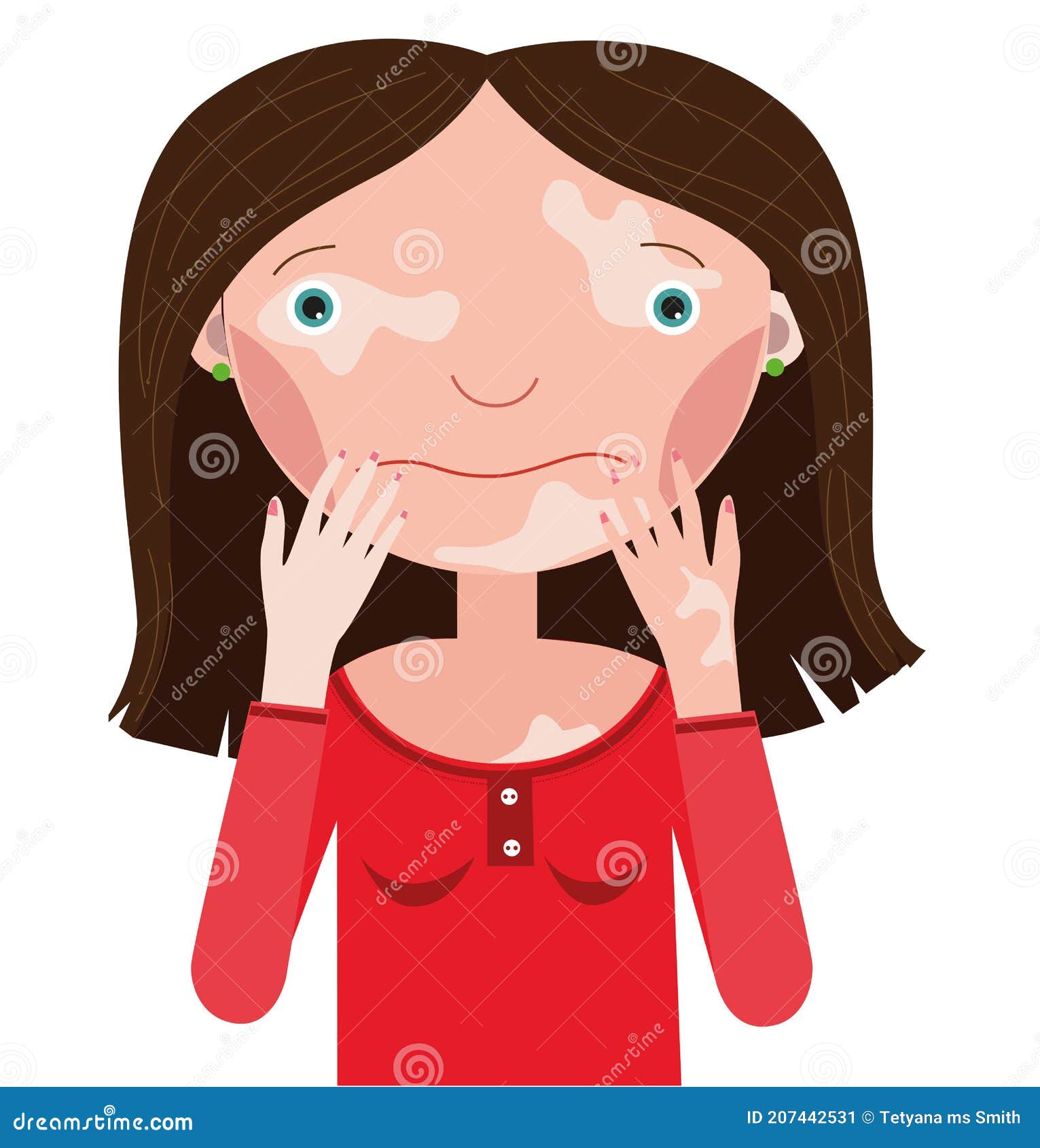 Vitiligo. White Spots On The Skin. Infographics Vector Illustration ...