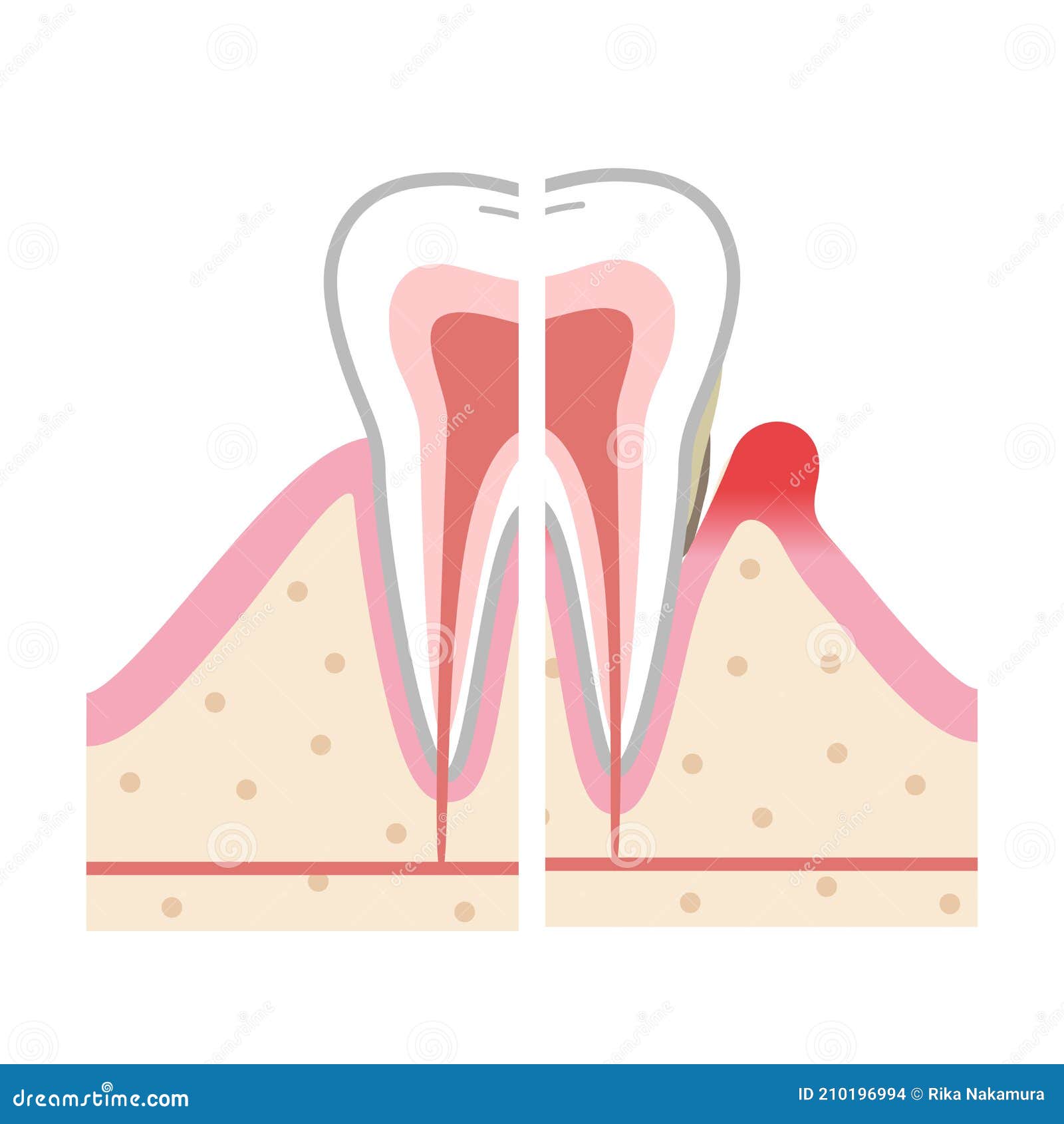 Progression Of Periodontal Disease Simple Illustration Of Teeth Cartoon ...