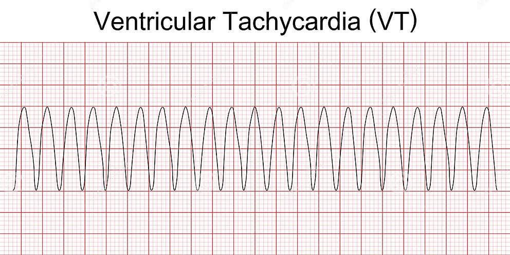 Electrocardiogram Show Monomorphic Ventricular Tachycardia VT. Stock ...