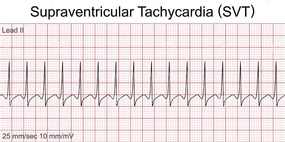 Electrocardiogram Show Supraventricular Tachycardia SVT Pattern. Stock ...