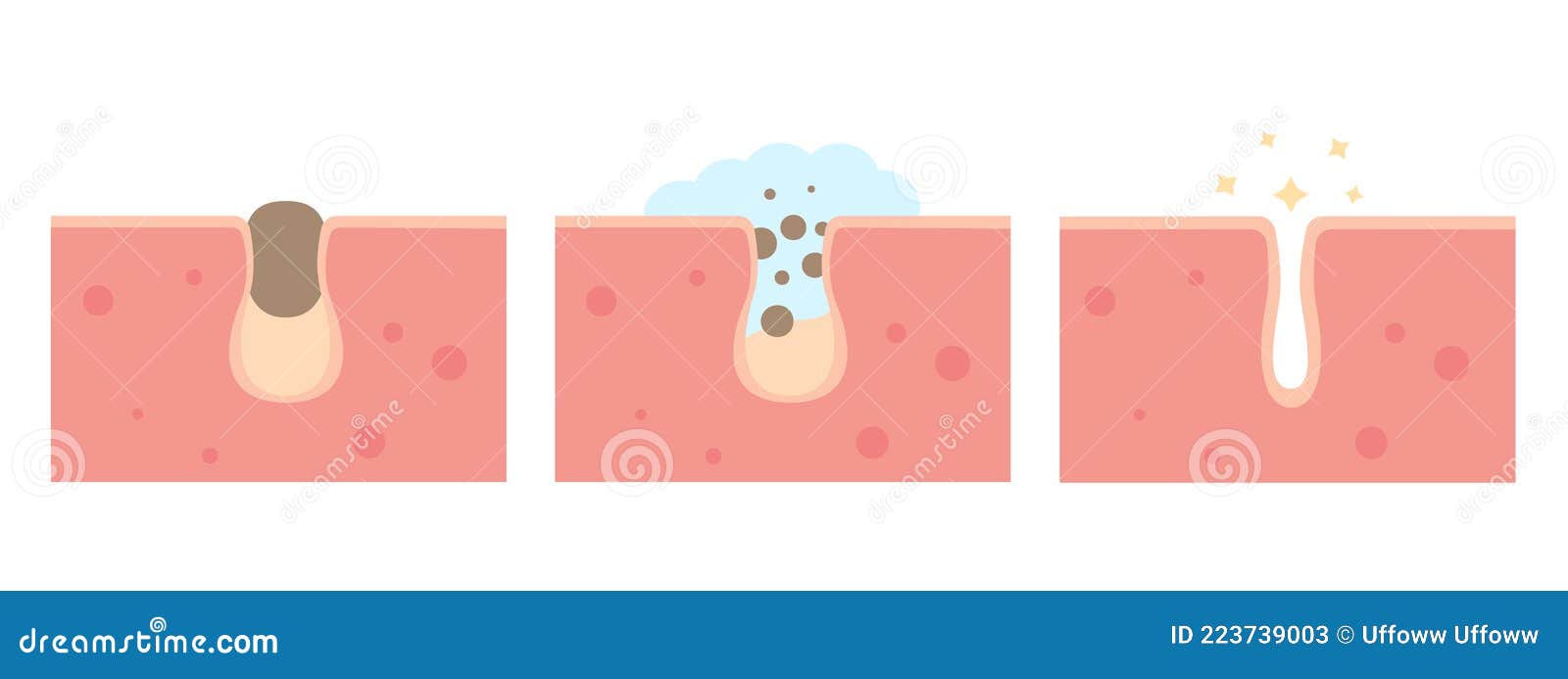 Cleaning Clogged Pores Process Stock Vector - Illustration of cleansing ...
