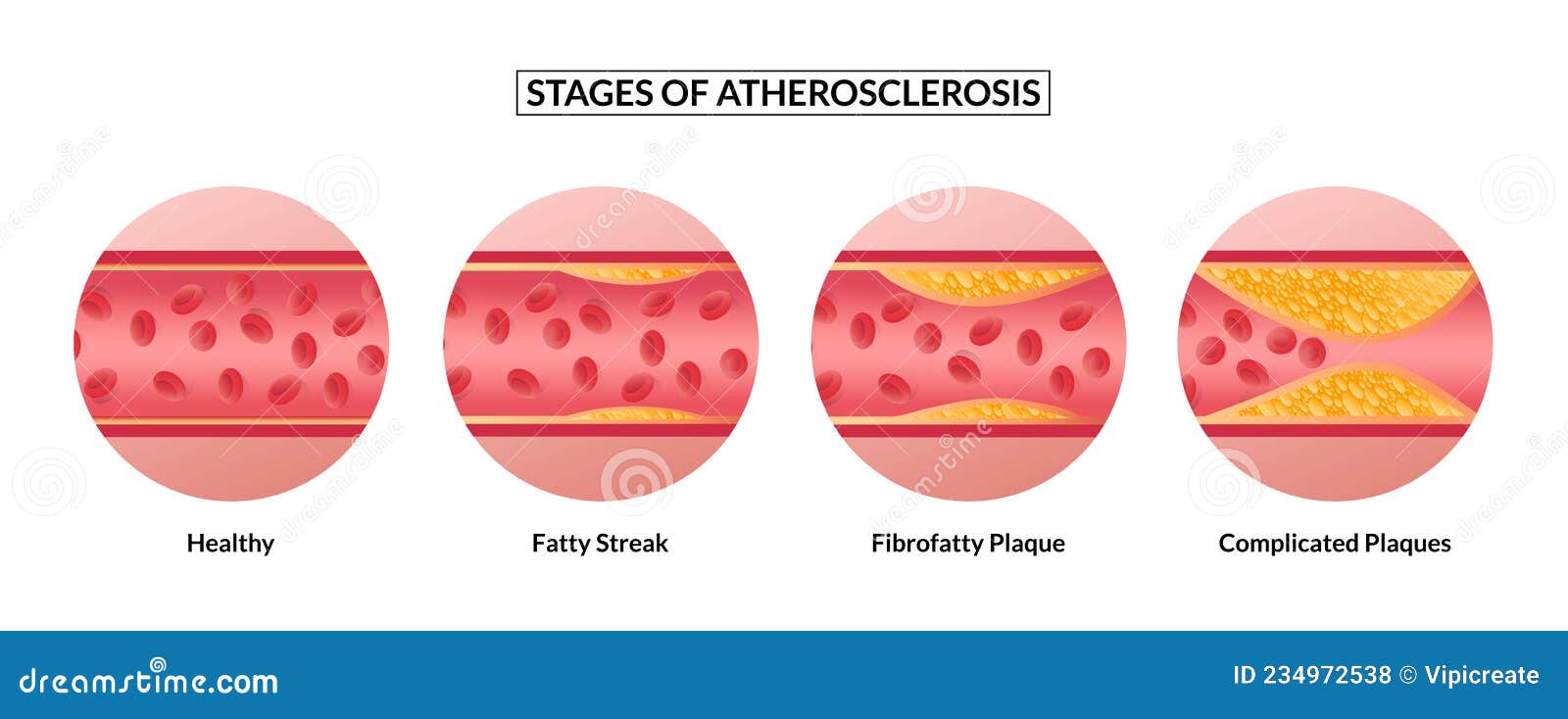 Stages Of Atherosclerosis. Atherosclerosis Formation Healthy Artery And ...