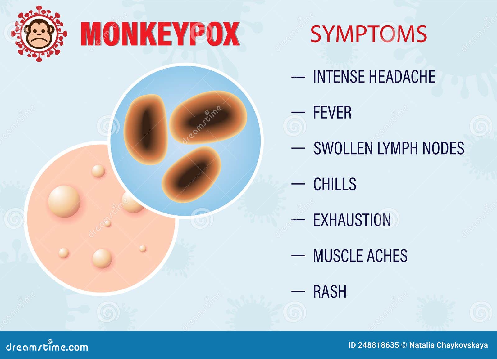 Symptoms Of Monkey Pox. Headache, Fever, Muscle Pain, Enlarged Lymph ...