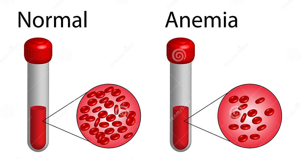 Iron Deficiency Anemia. Vector Illustration Isolated on White ...