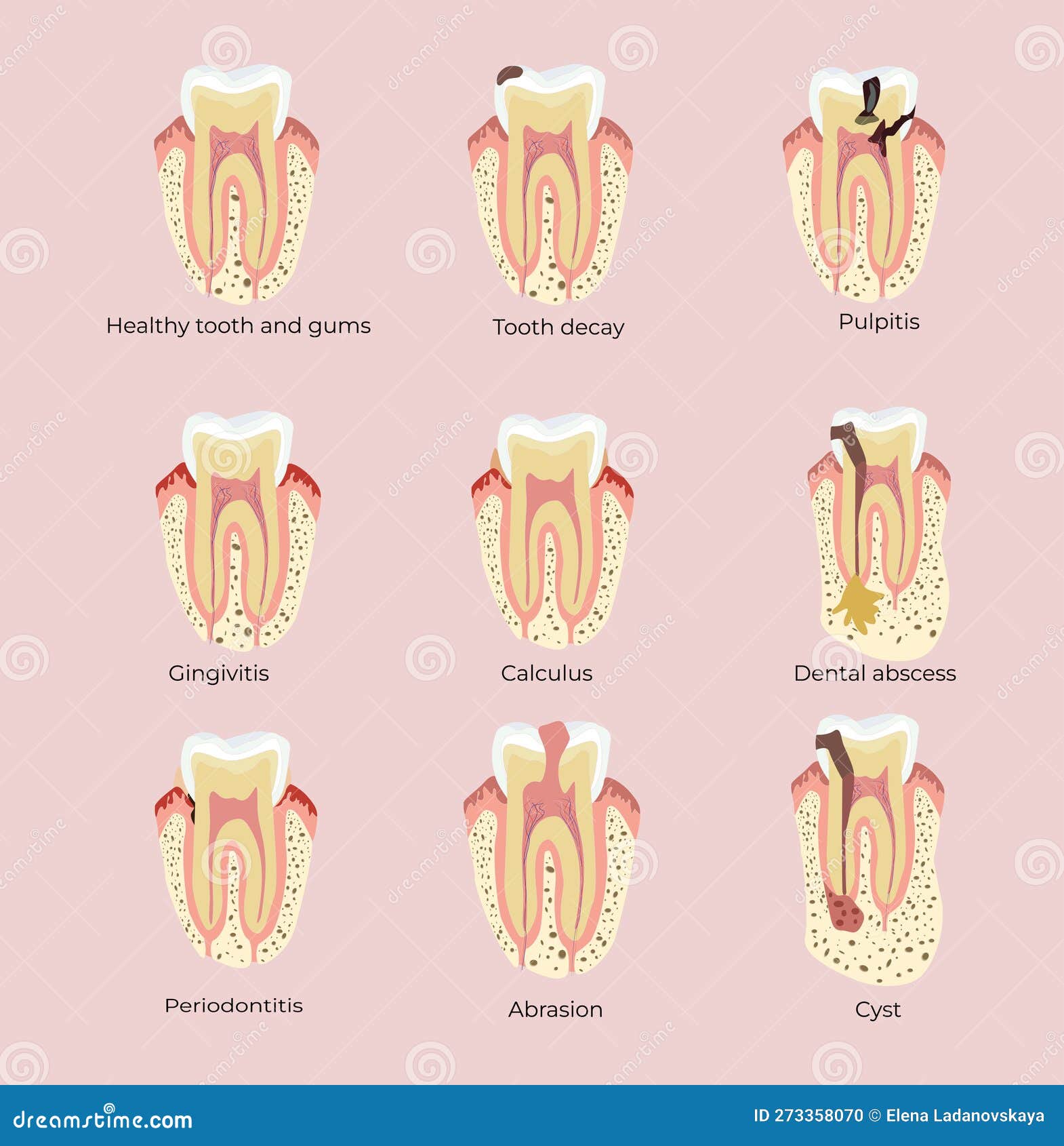 Dental Diseases Set of Teeth Healthy Stock Vector - Illustration of ...