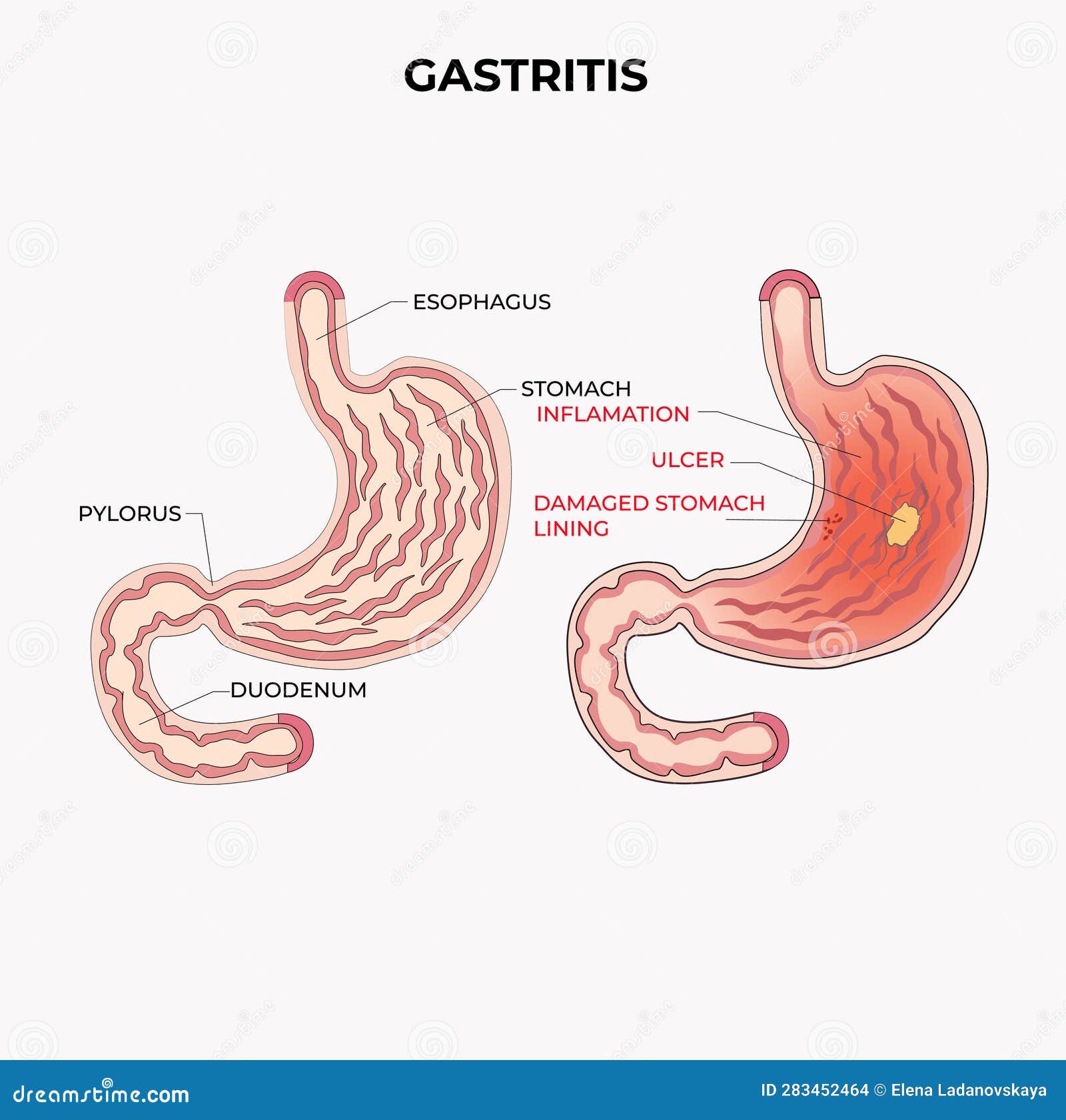 Inflamation Cartoons, Illustrations & Vector Stock Images - 150 ...