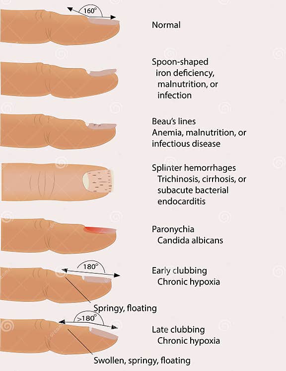 Nail Disease?information Poster for Podiatrists Stock Illustration ...