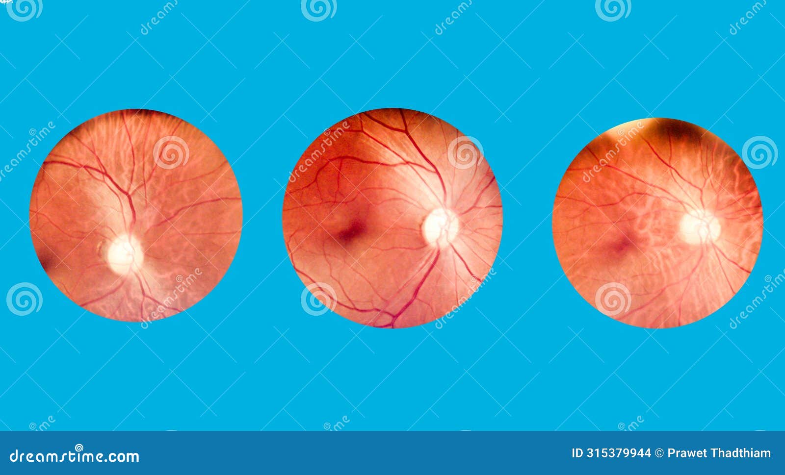 Patient Elderly with Retina of Diabetes.Human Eye Anatomy Taking Images ...