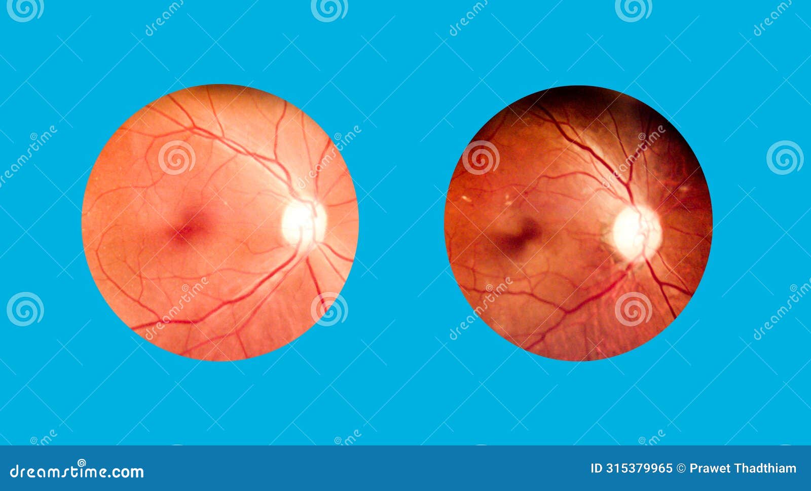 Fundoscopy Cartoons, Illustrations & Vector Stock Images - 261 Pictures ...