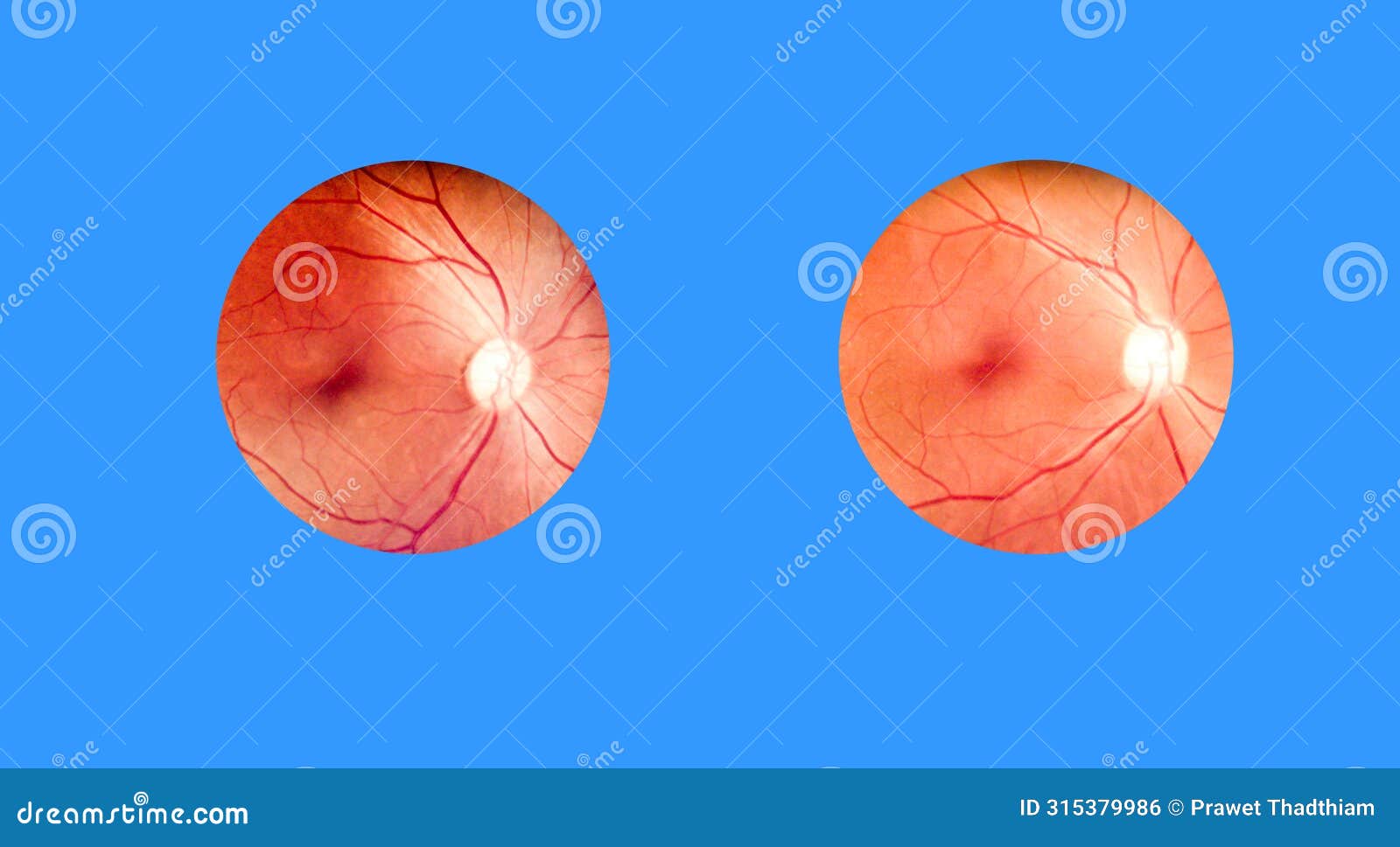 Patient Elderly With Retina Of Diabetes.Human Eye Anatomy Taking Images ...