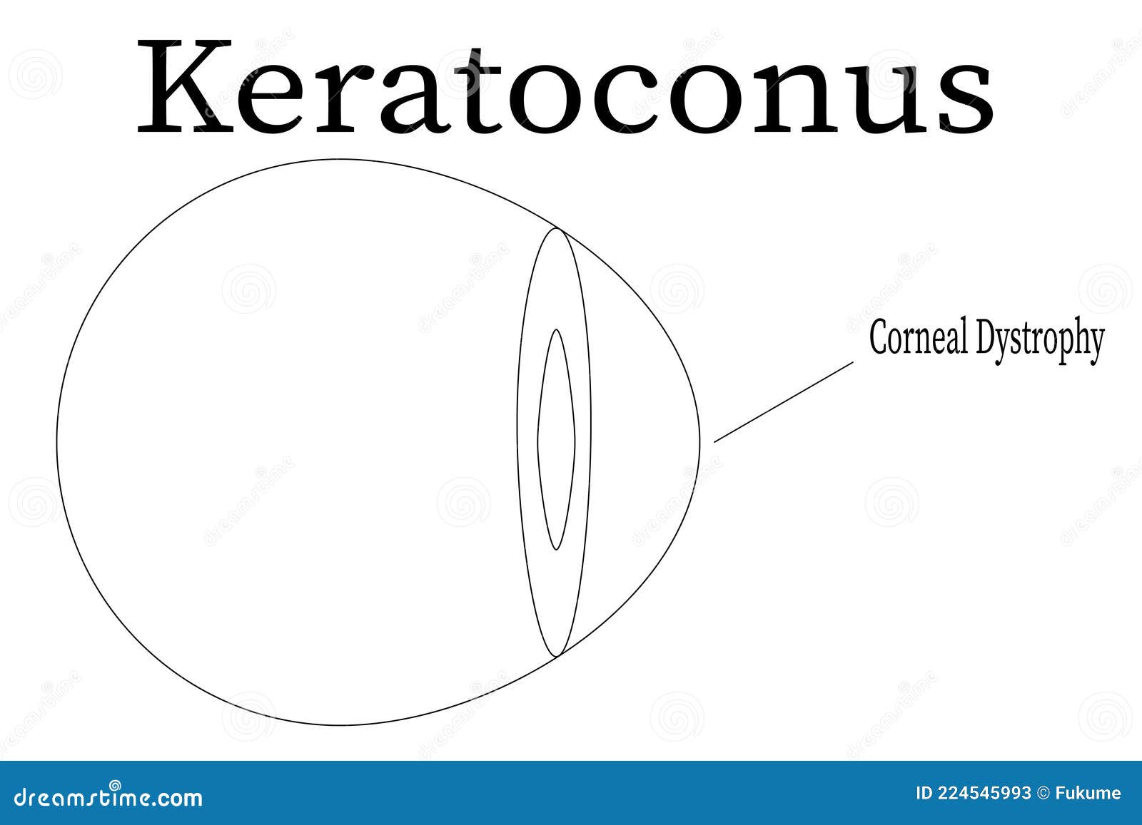 Photophobia Can Blind Our Views And Limit Perspective - Pictured As ...