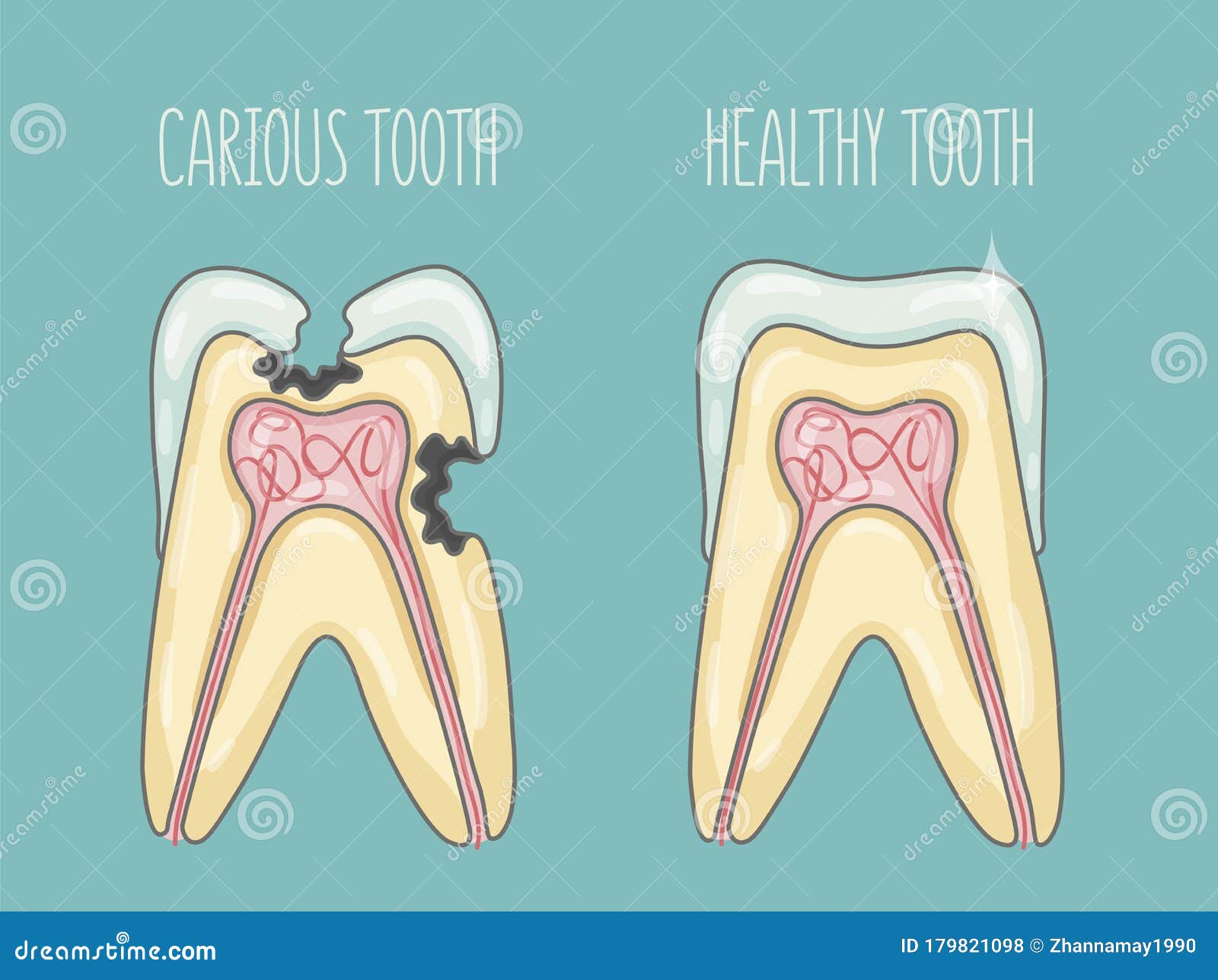 Healthy and Caries Human Teeth. Stock Vector - Illustration of brushing ...